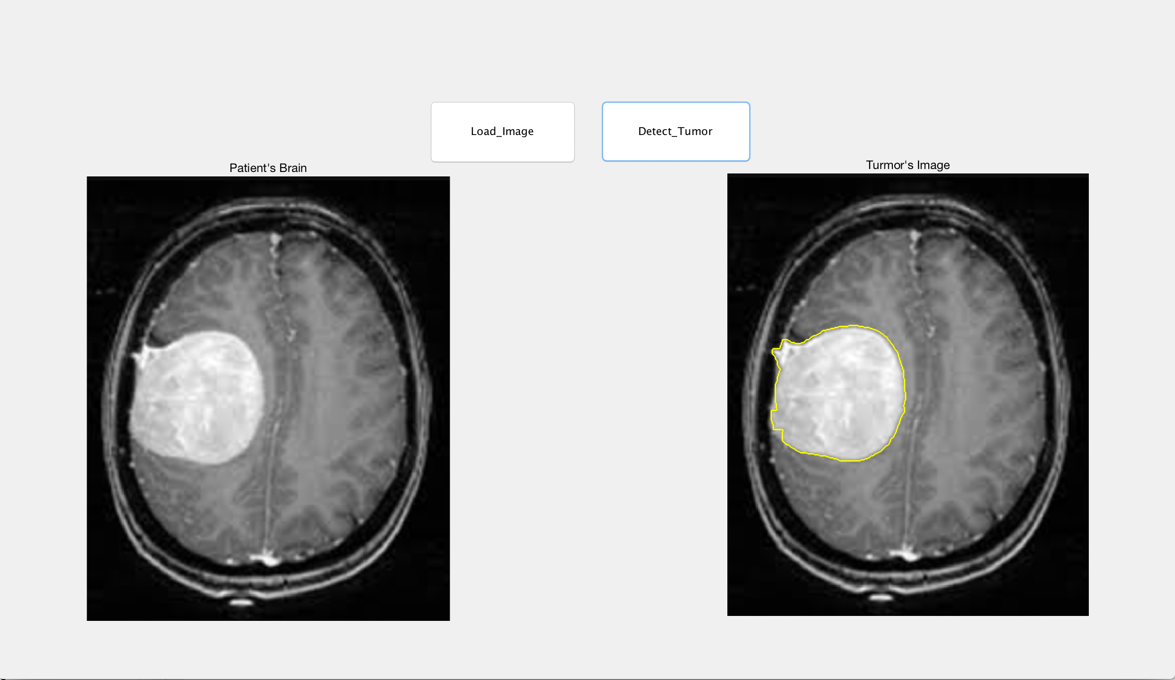 Brain Cancer Detector : 3 Steps - Instructables