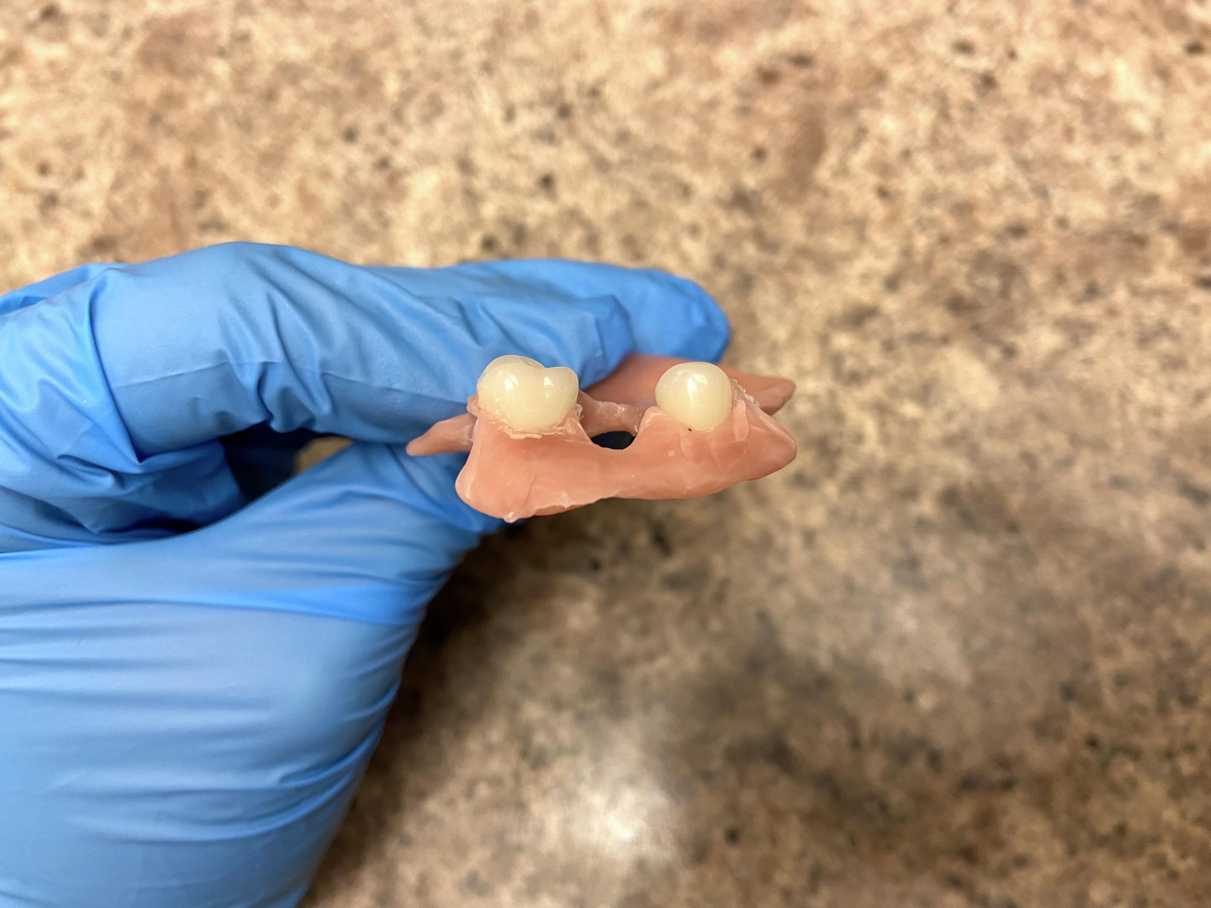 DIY Dentures / Temporary Tooth : 6 Steps - Instructables