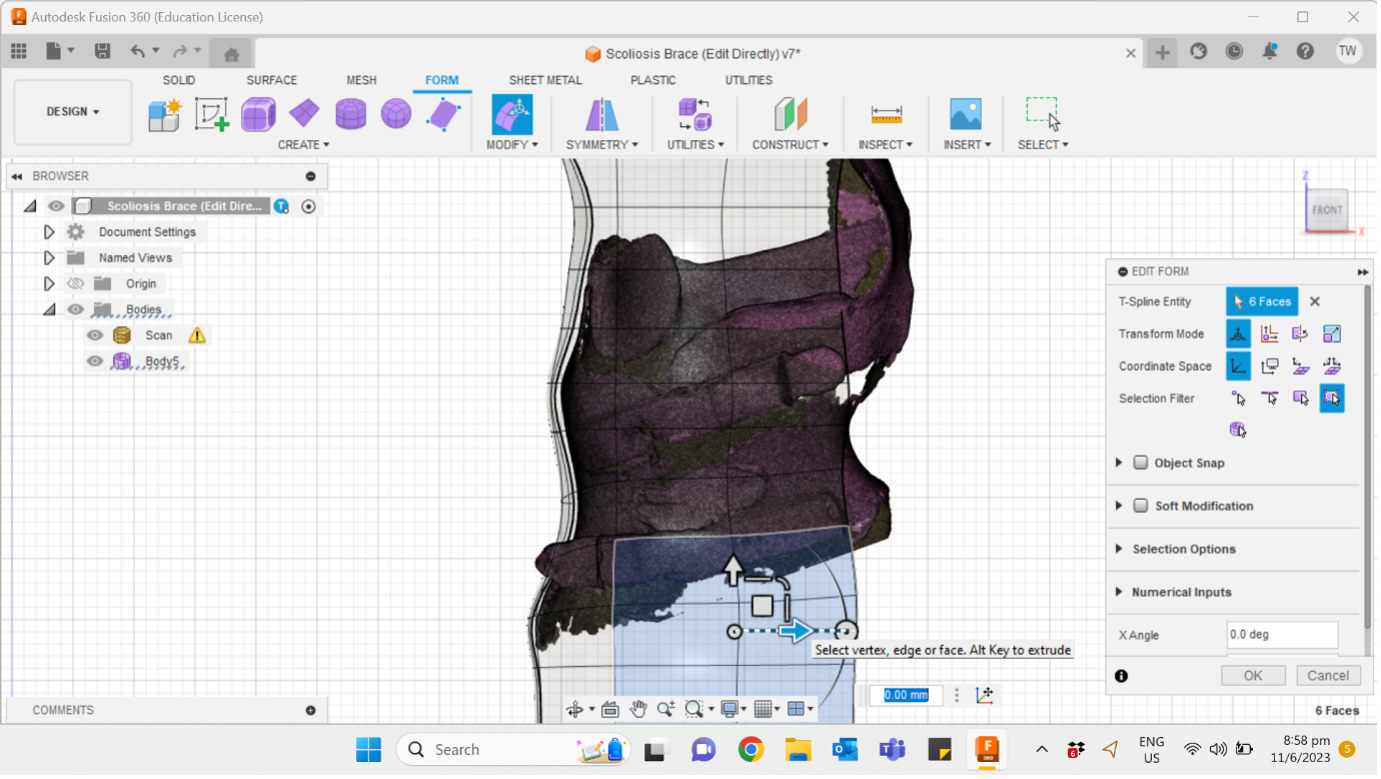 3D Printed Back Brace for Scoliosis : 7 Steps (with Pictures ...