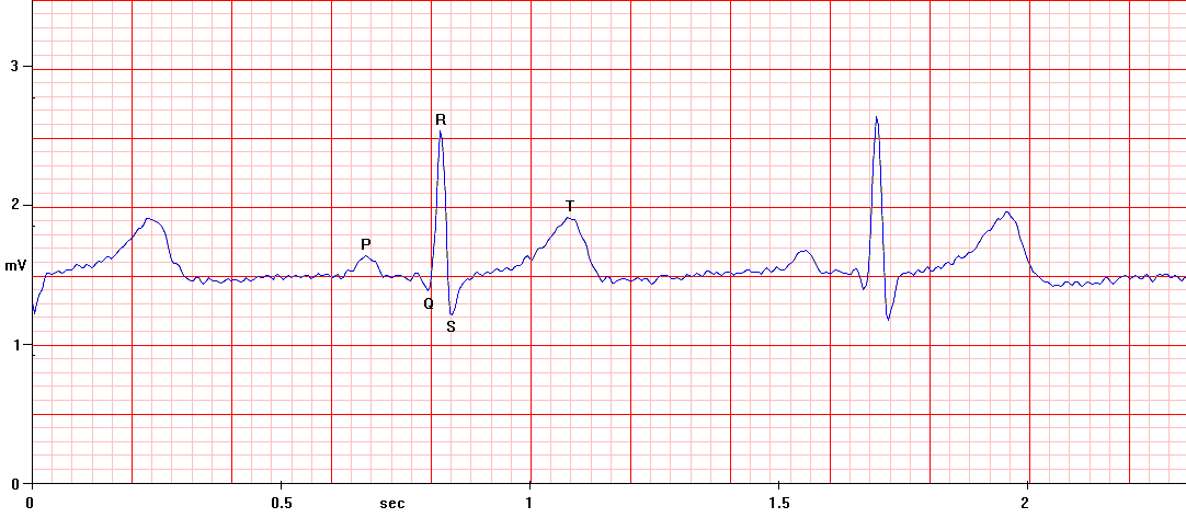 ECG Display With Arduino : 13 Steps (with Pictures) - Instructables