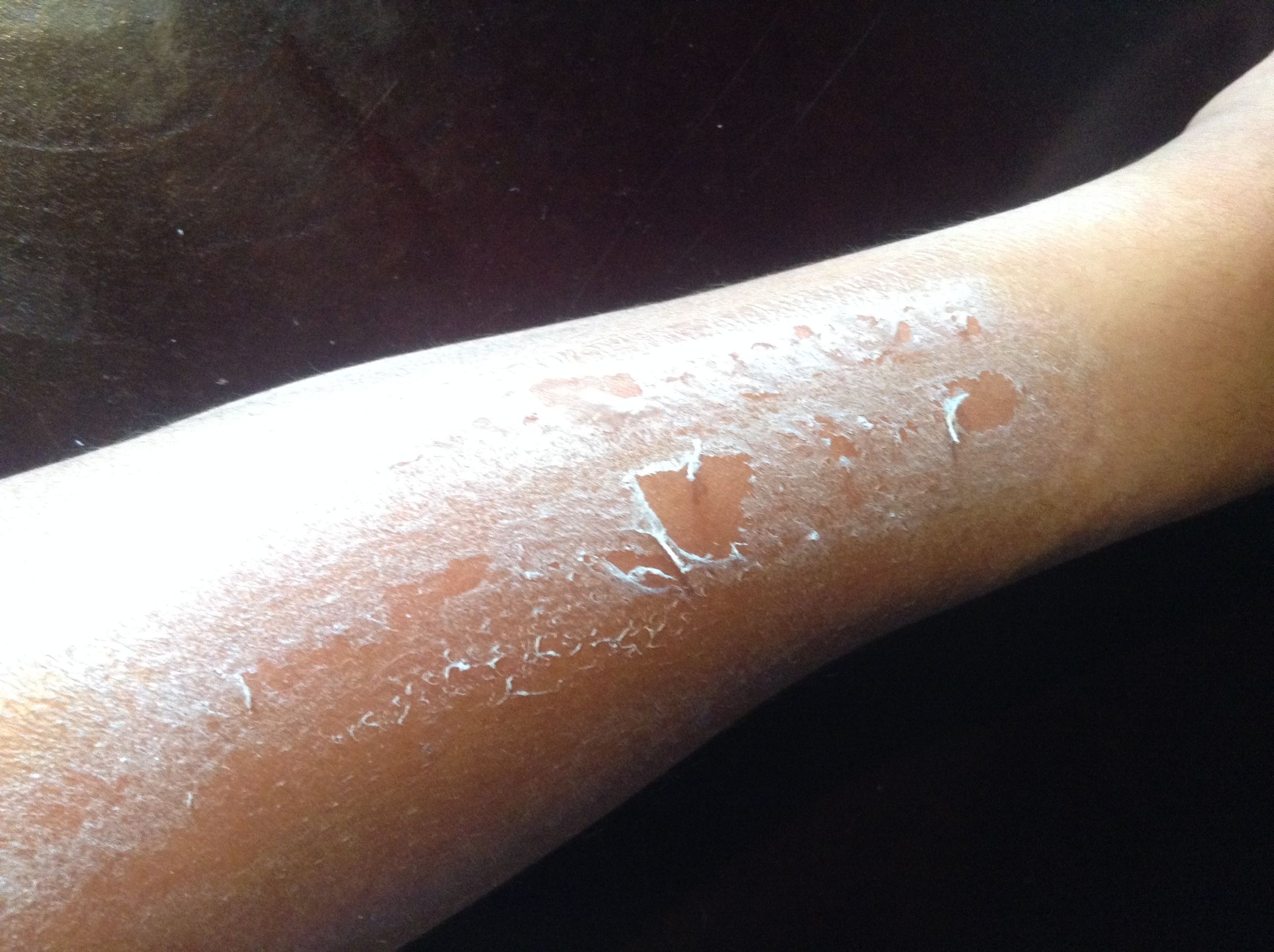 How to Scrape Your Arm : 5 Steps - Instructables