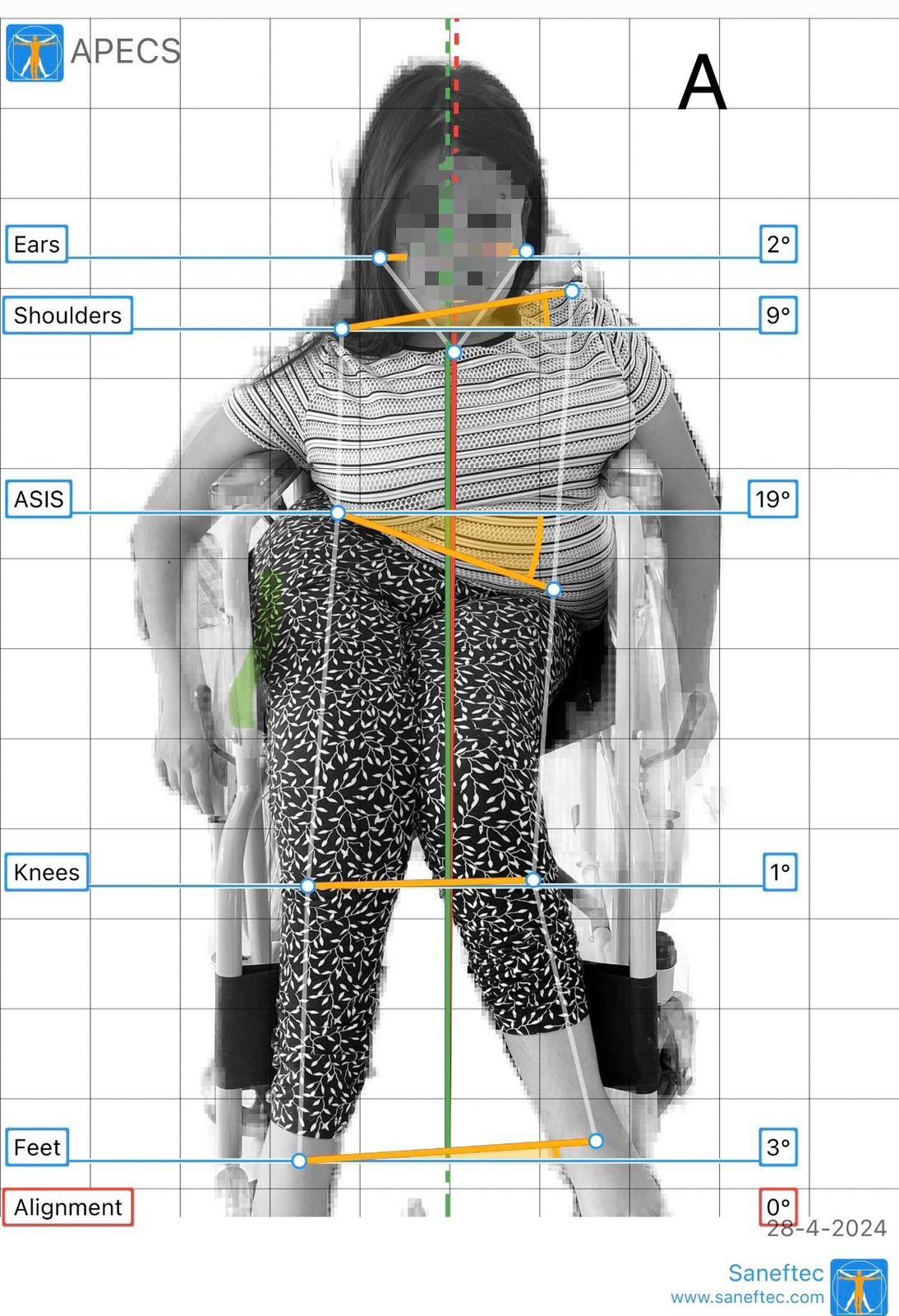 Elaboration of Lateral Trunk Supports for a Wheelchair User With ...