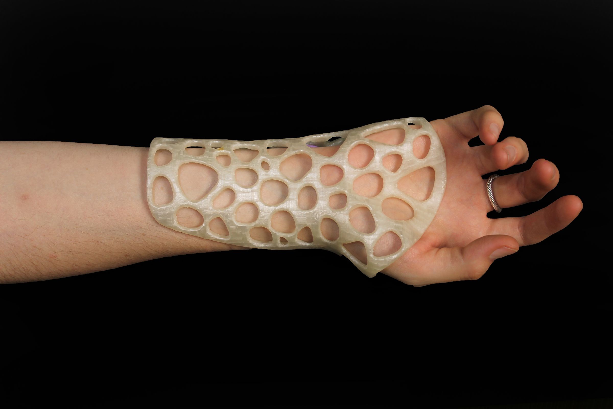 3D Printed Wrist Orthosis : 12 Steps (with Pictures) - Instructables