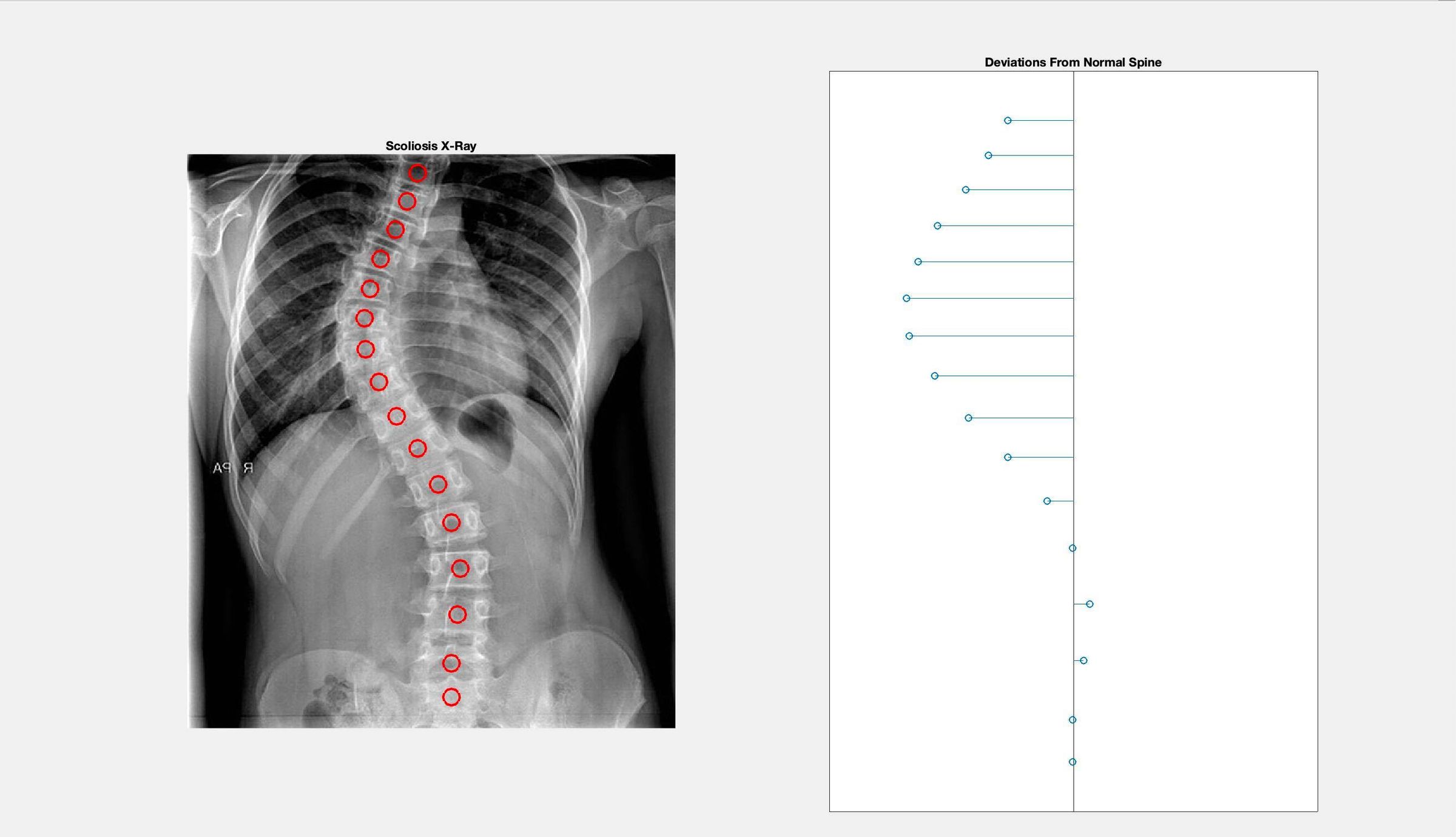 Analysis of Scoliosis X-Rays and Spinal Deviation : 6 Steps - Instructables