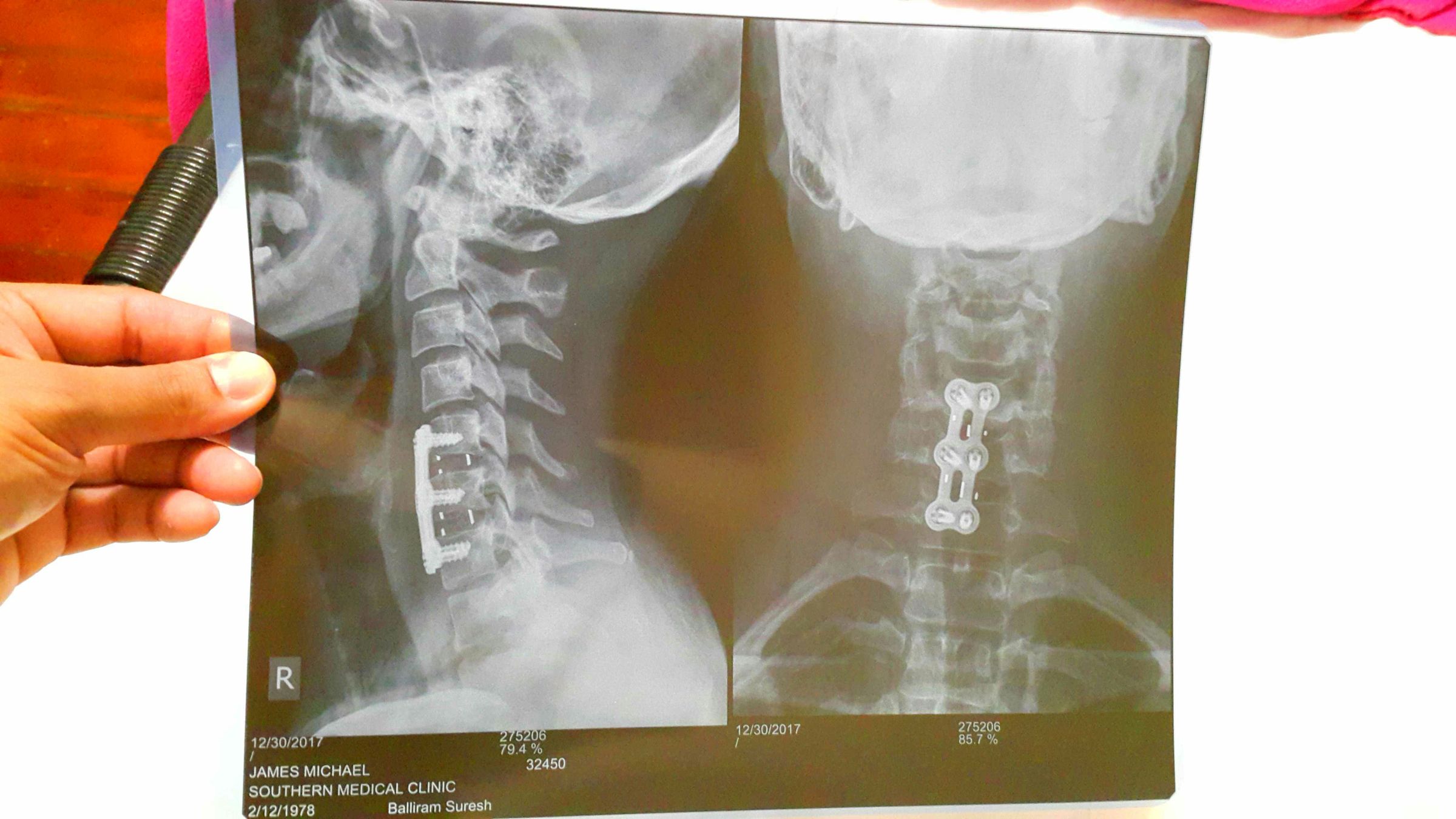Coping With Anterior Cervical Discectomy and Fusion (ACDF) Surgery. : 3 ...