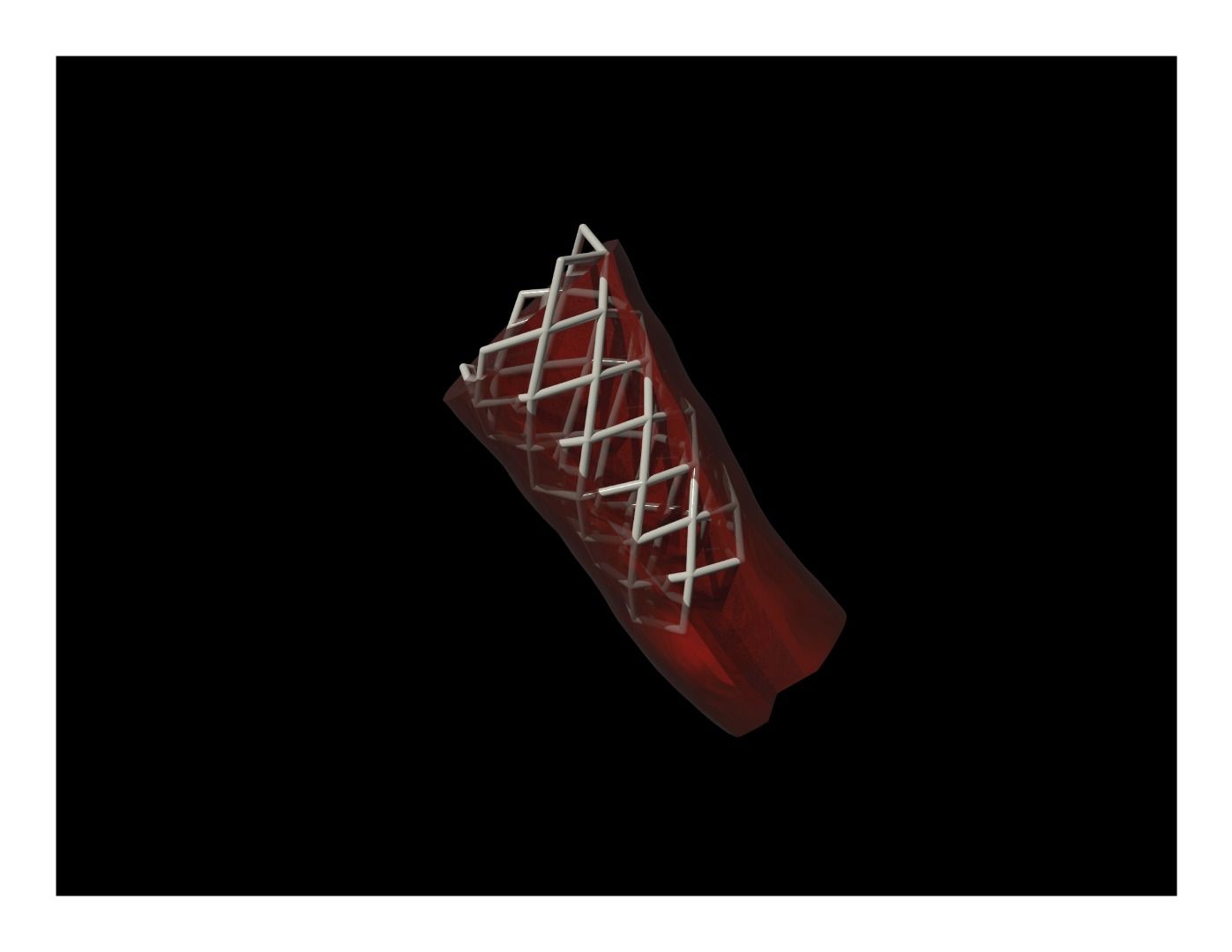 Create a Custom 3D Printable Prosthetic Device Using Data From a CT ...