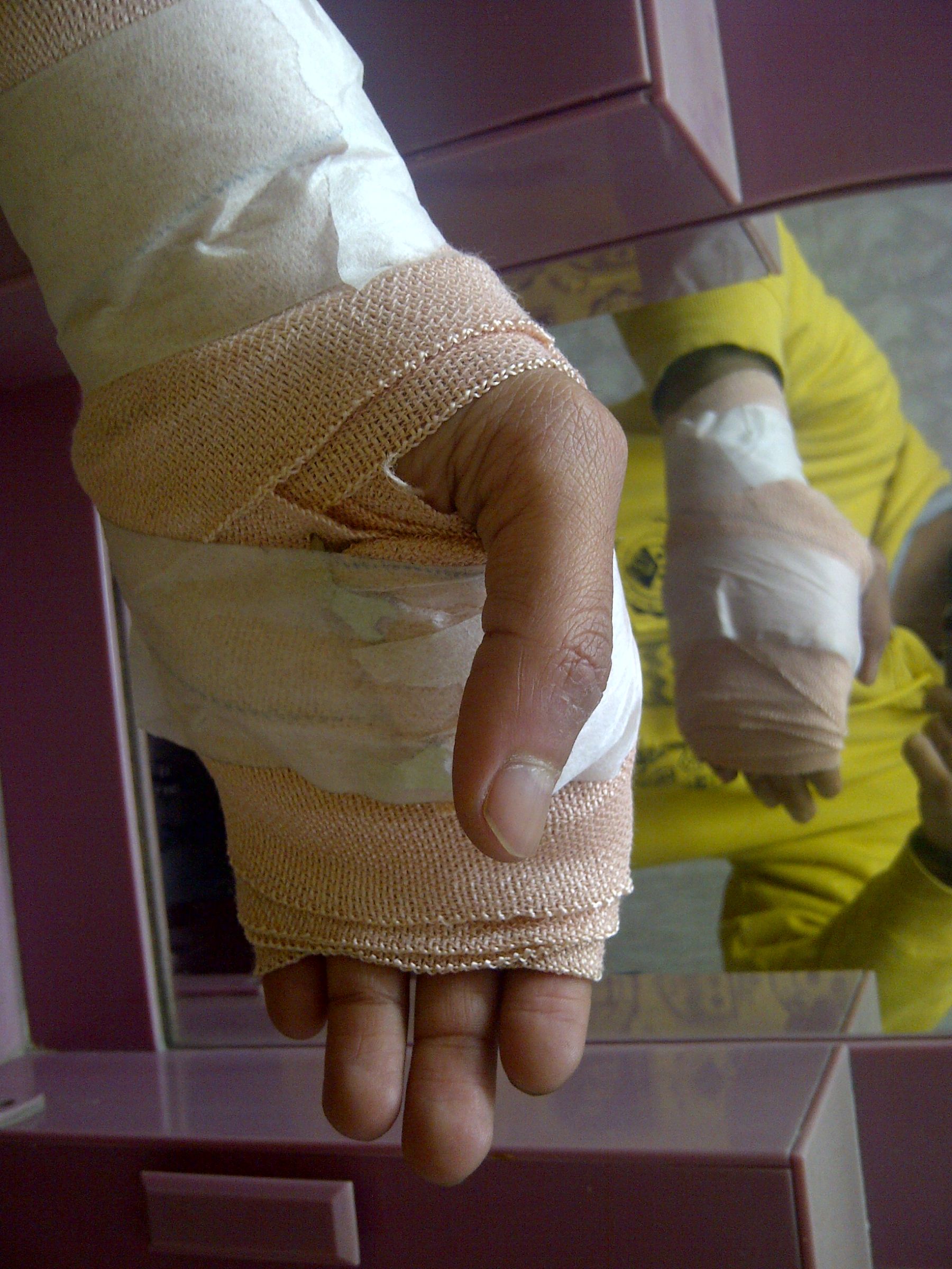 Broken / Sprained Hand Secret Compartment - (Made for a Contest Long ...