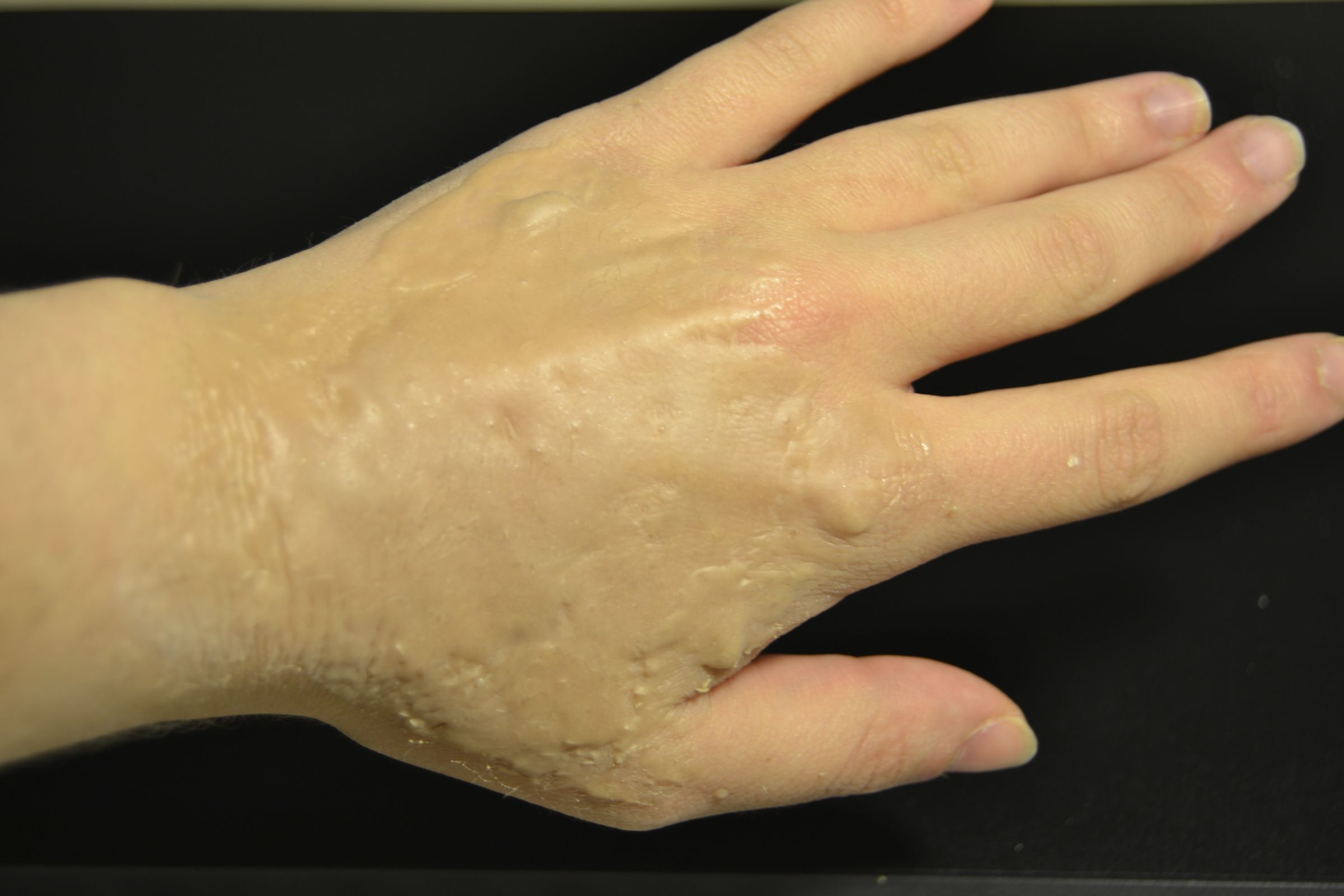 Fake Burned Skin : 4 Steps (with Pictures) - Instructables