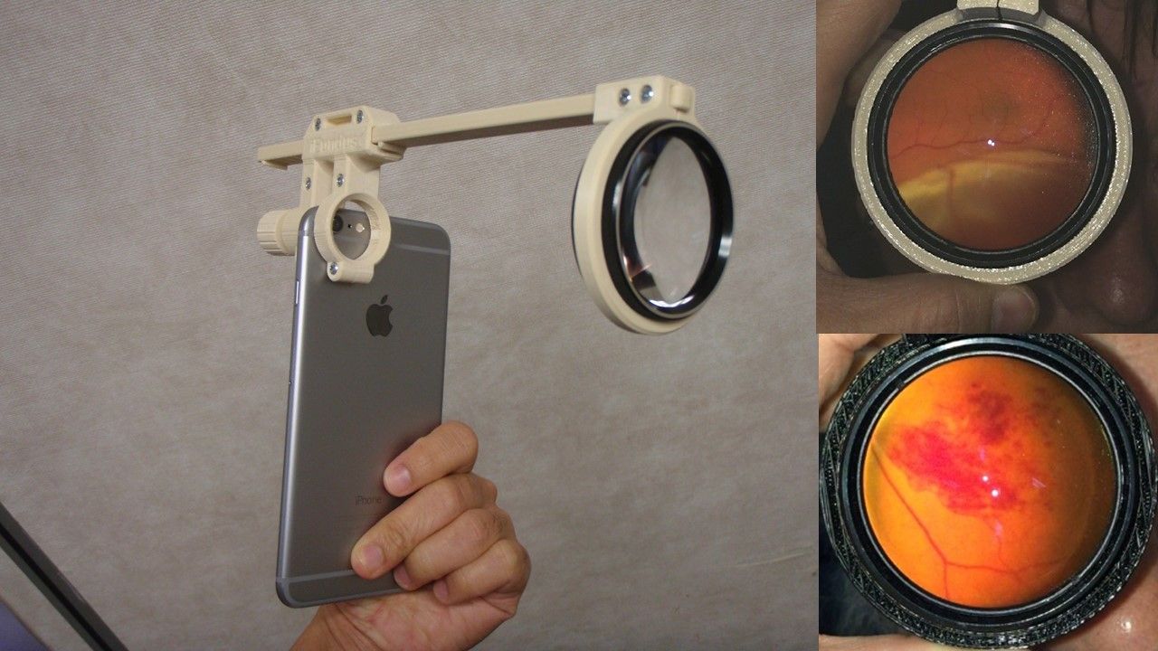 Smartphone Ophthalmoscope ODocs Fundus : 3 Steps (with Pictures ...