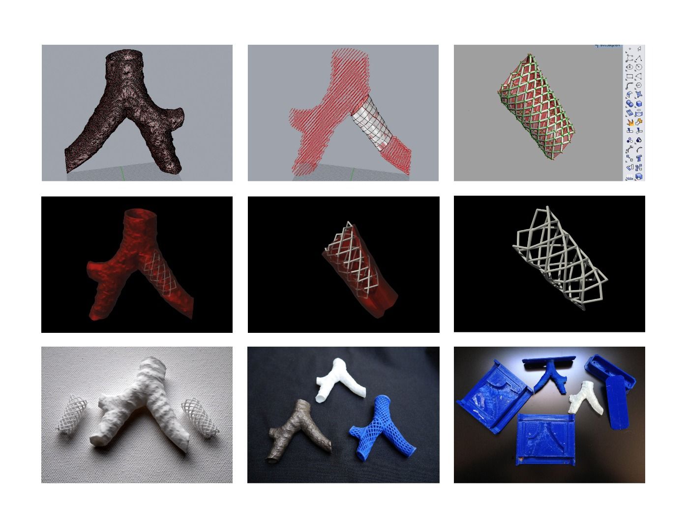 Create a Custom 3D Printable Prosthetic Device Using Data From a CT ...