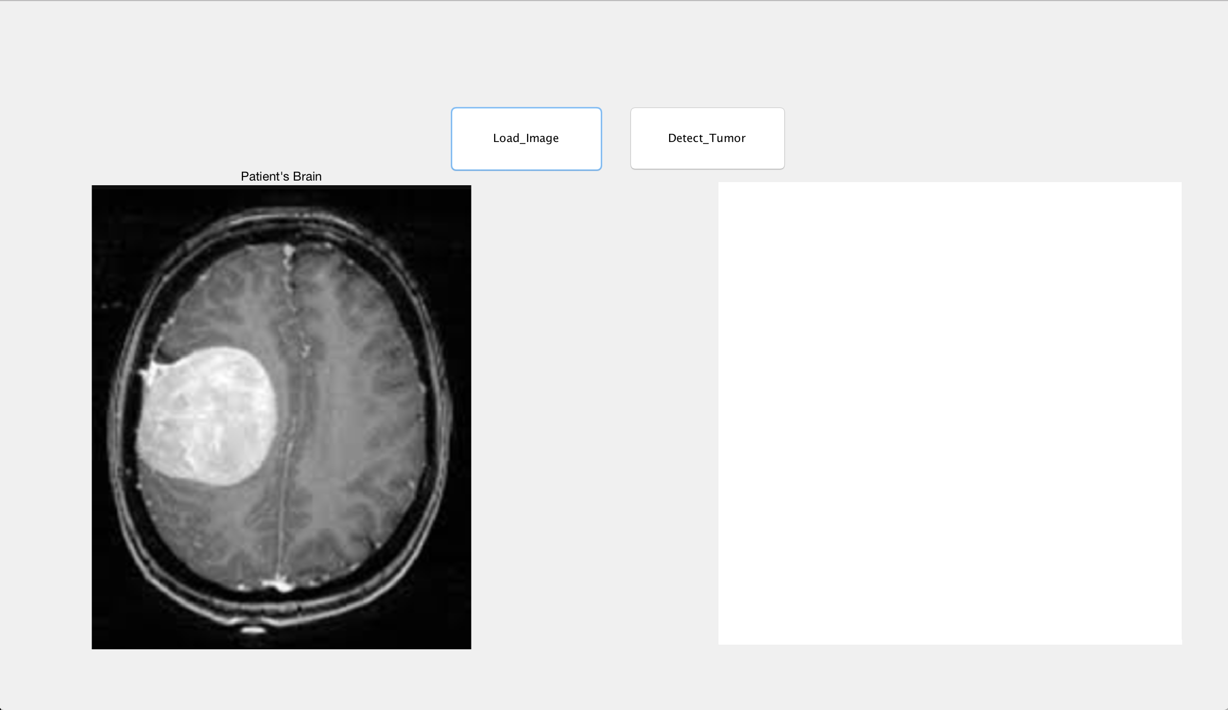 Brain Cancer Detector : 3 Steps - Instructables