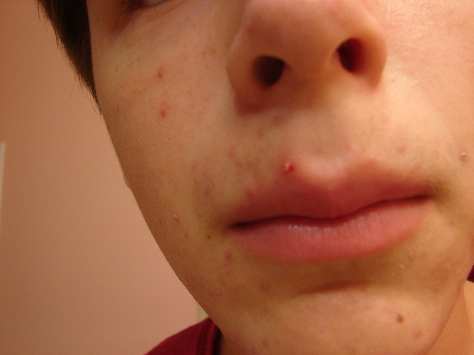 How to Pop a Pimple : 3 Steps (with Pictures) - Instructables