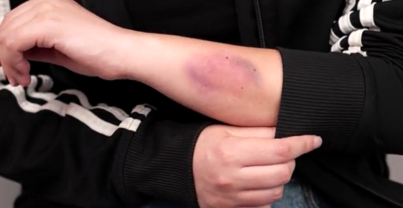 How to Make a Simple Fake Bruise (A Total of 3 Ways) : 3 Steps ...
