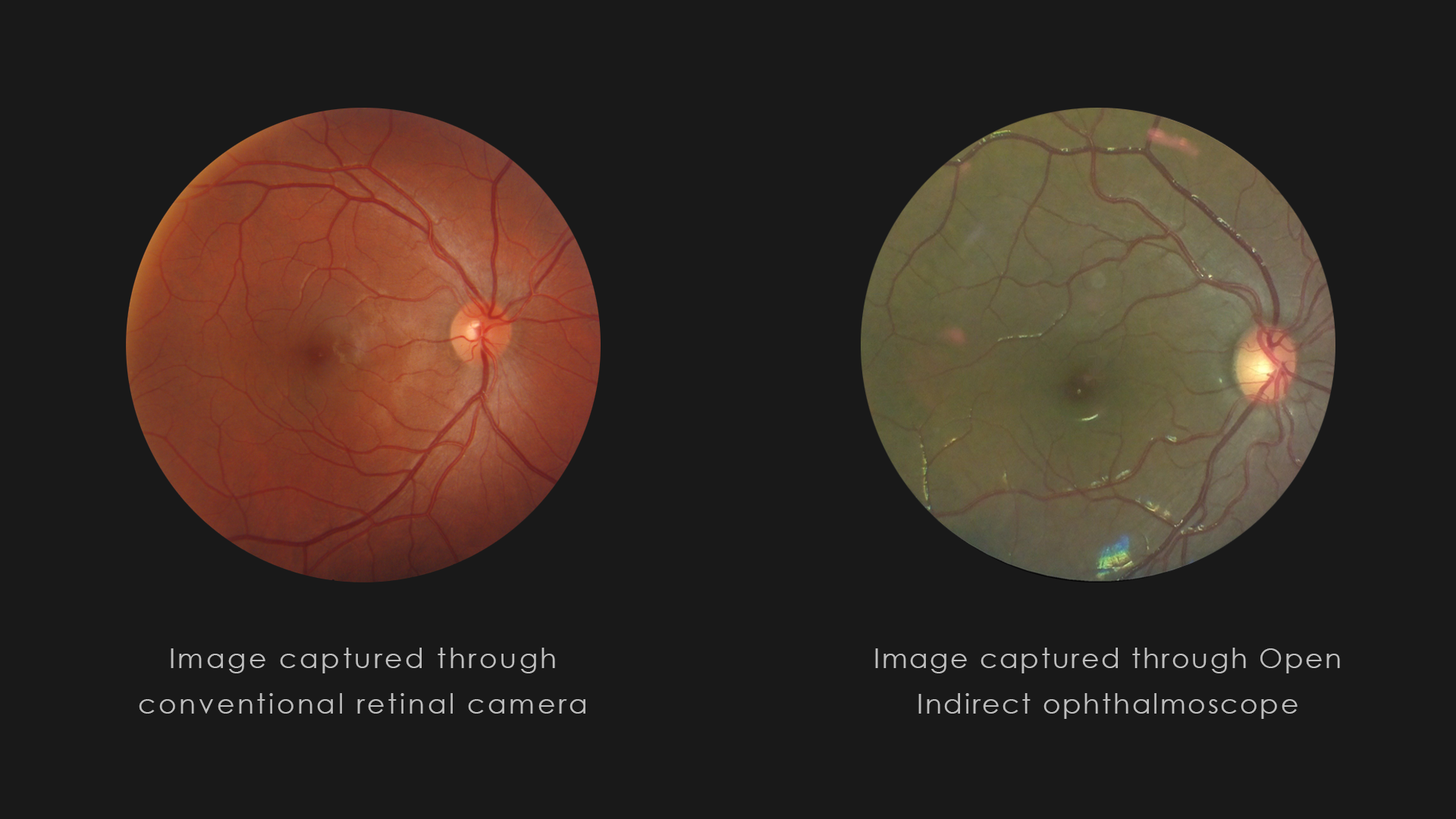 Open Indirect Ophthalmoscope (OIO) : 10 Steps (with Pictures ...