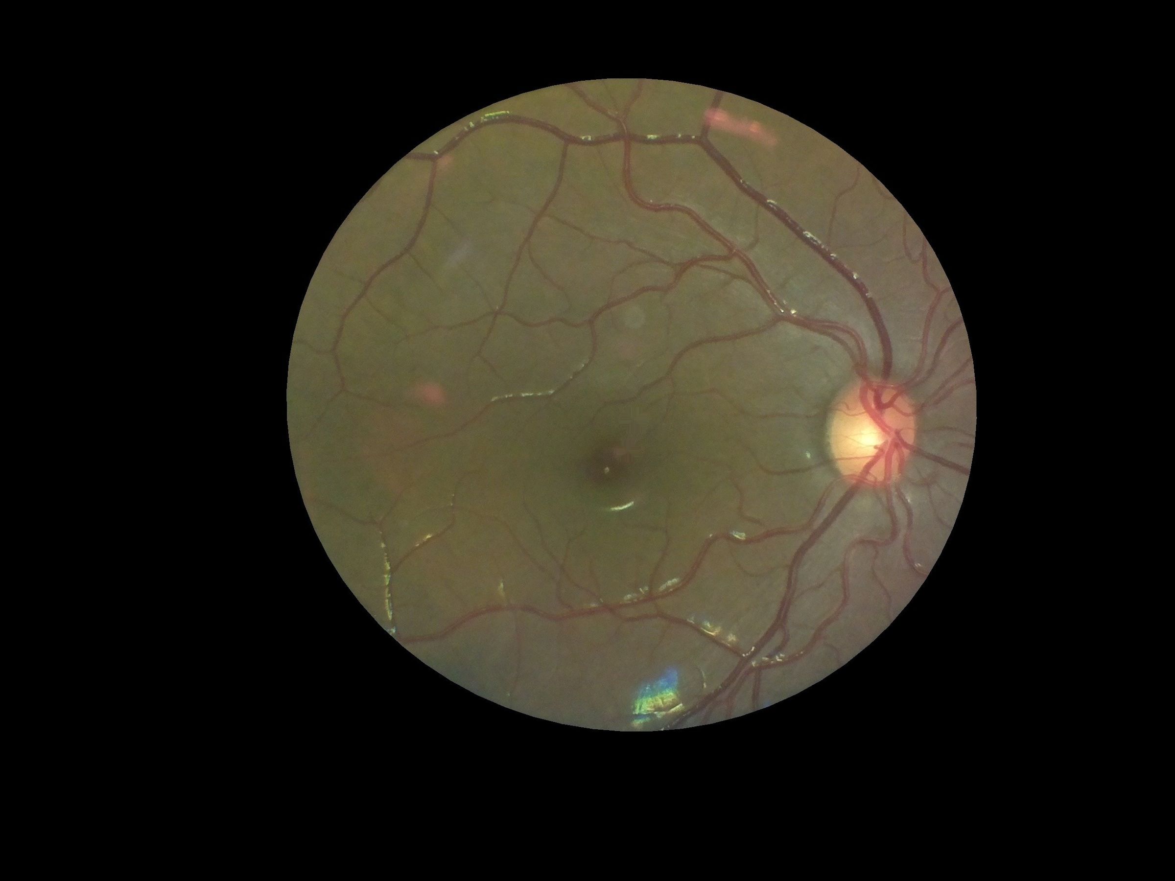 Open Indirect Ophthalmoscope (OIO) : 10 Steps (with Pictures ...
