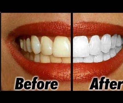 How to Have Natural White Teeth in 2 Minutes - Instructables