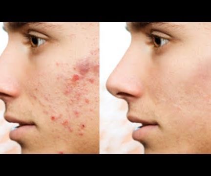How to Remove Acne and Zits With Photoshop : 4 Steps (with Pictures ...