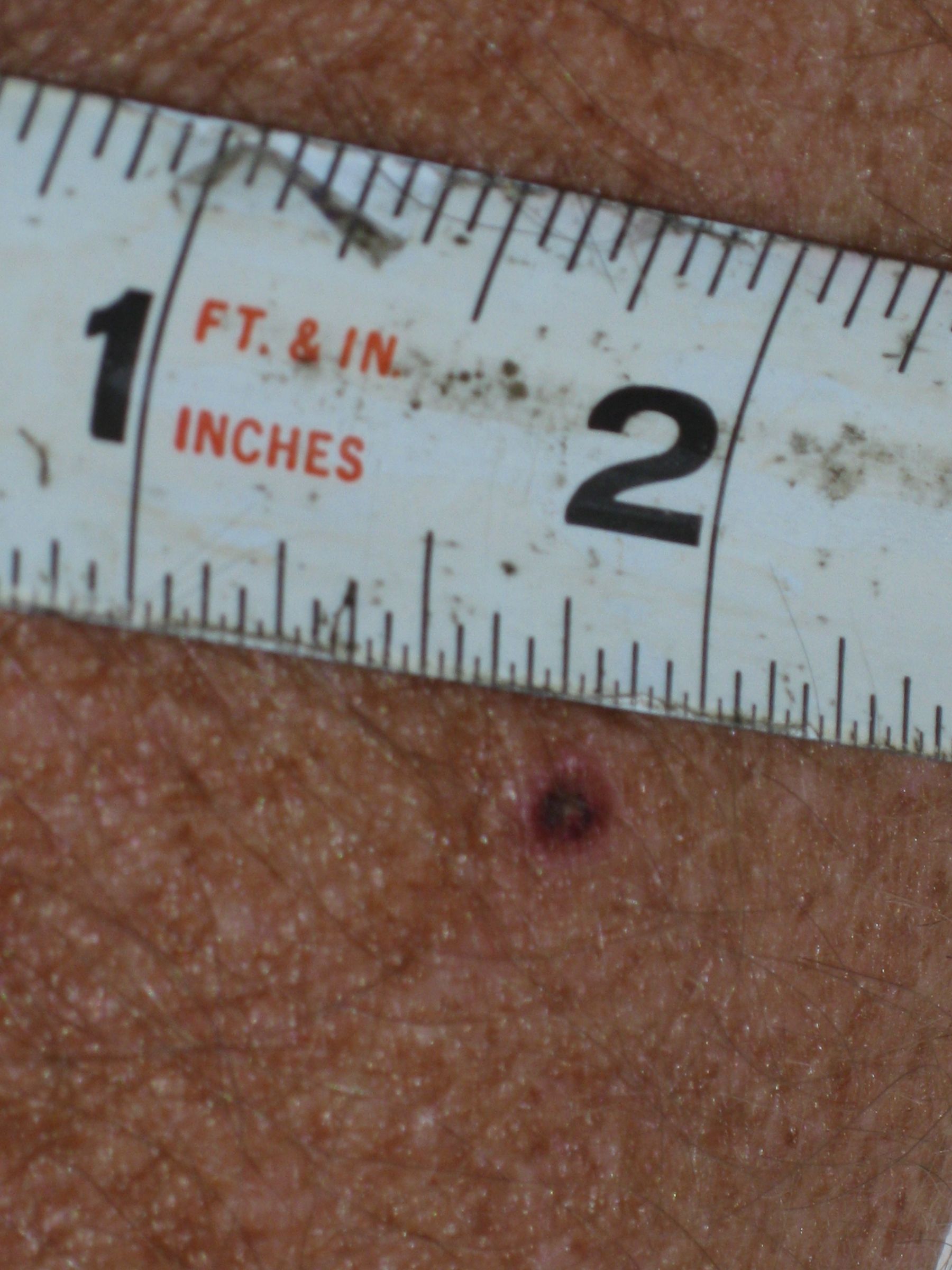 Electronic Wart Removal - No Blood! Little Pain. : 6 Steps - Instructables
