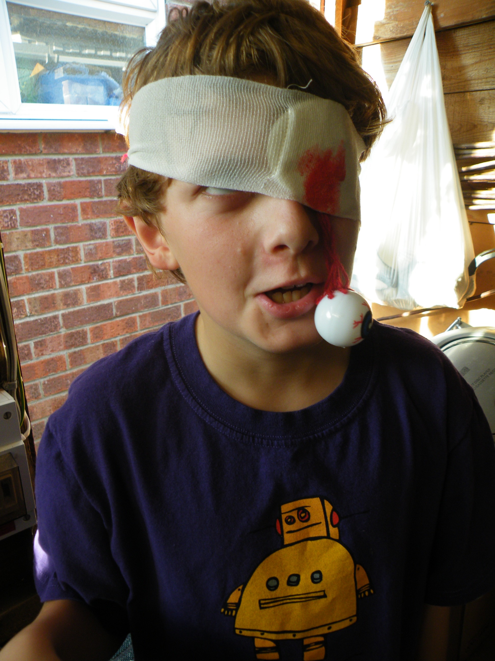 Eyeball Hanging Out Of Socket