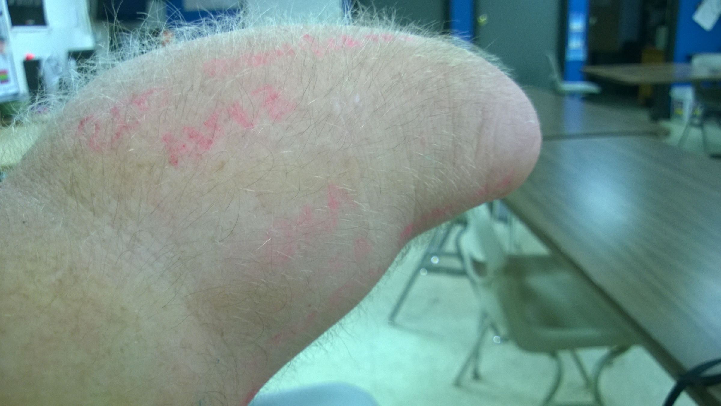 Fuzzy Stump Socket Prosthetic : 12 Steps (with Pictures) - Instructables