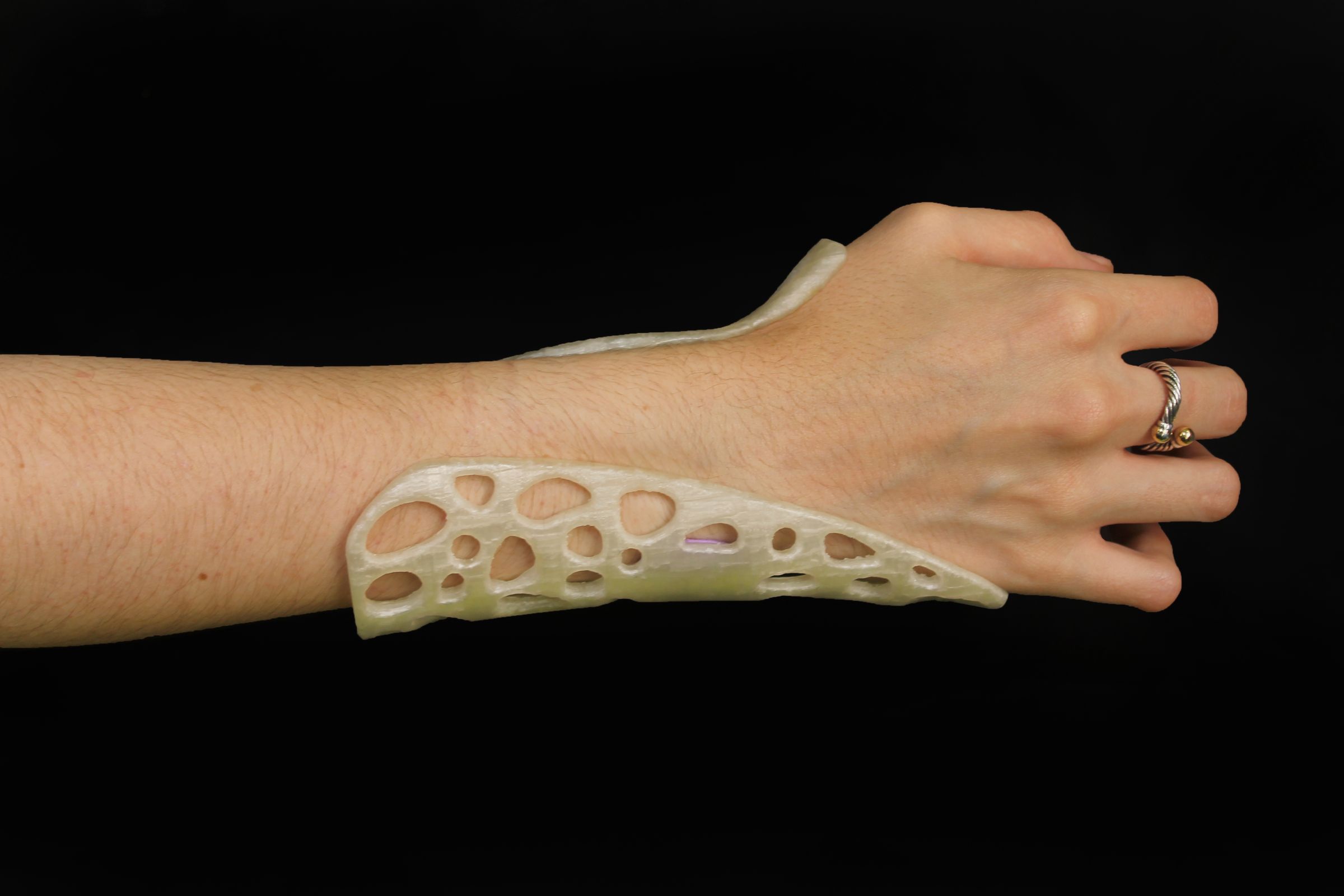 3D Printed Wrist Orthosis : 12 Steps (with Pictures) - Instructables