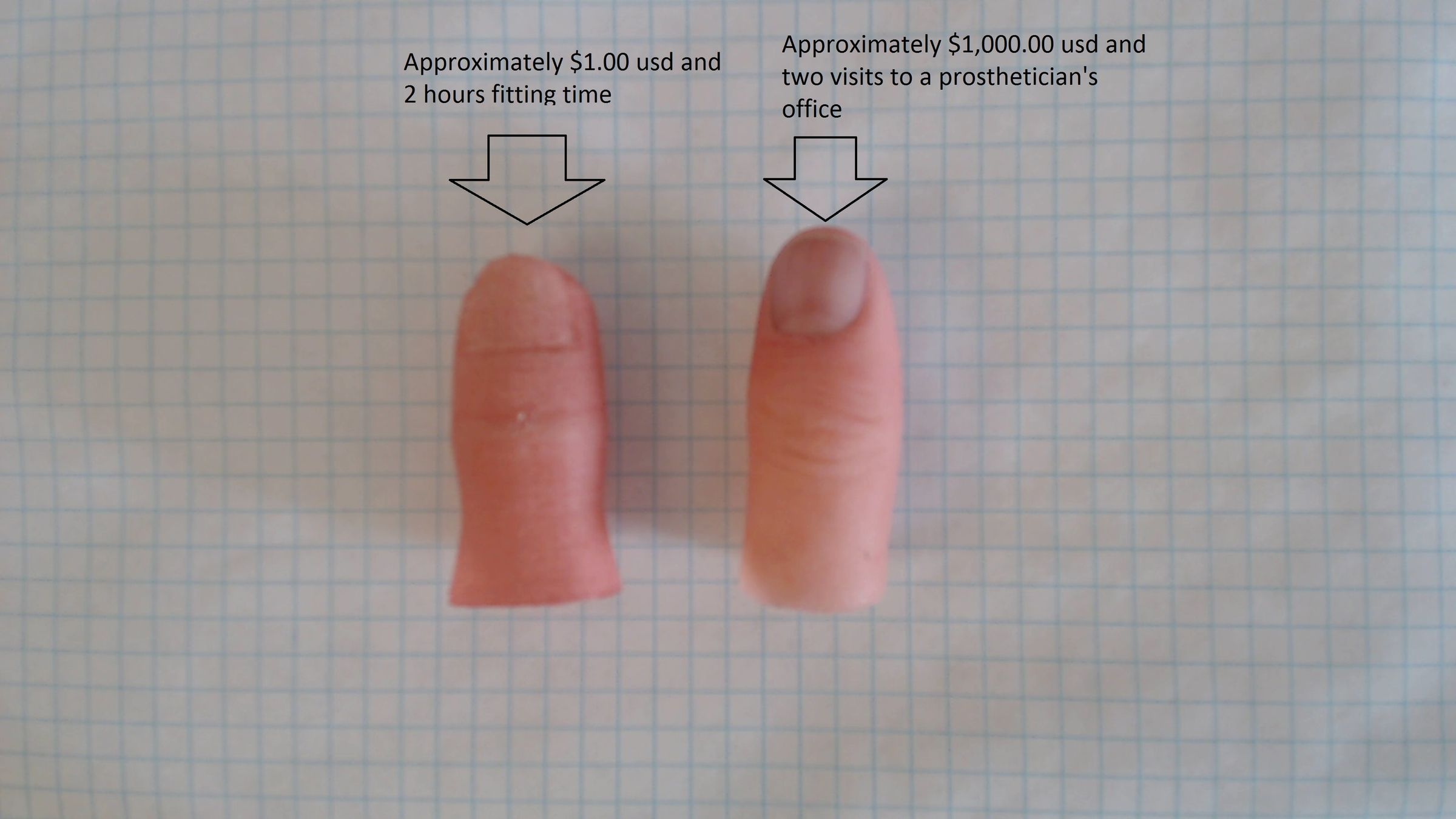 Thumb Prosthesis : 12 Steps (with Pictures) - Instructables
