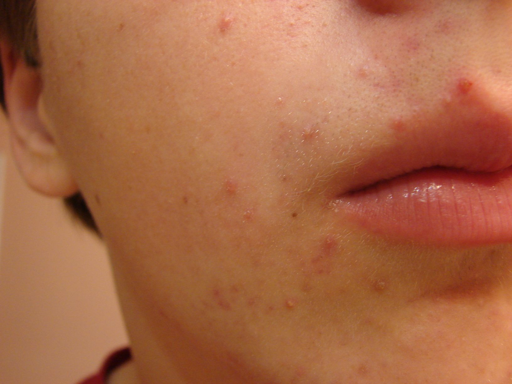 How to Pop a Pimple : 3 Steps (with Pictures) - Instructables