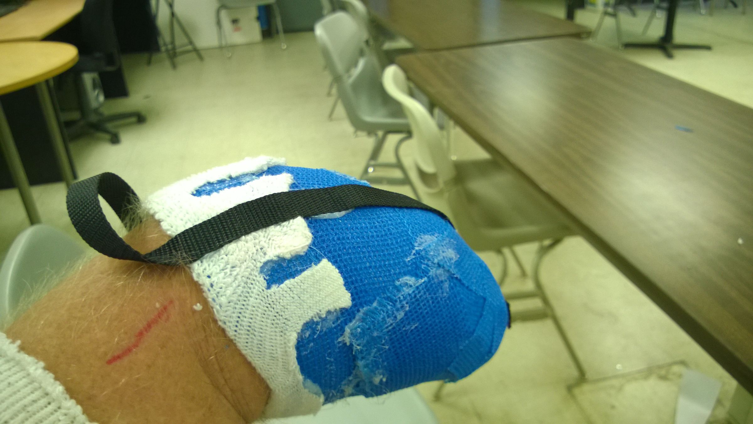 Fuzzy Stump Socket Prosthetic : 12 Steps (with Pictures) - Instructables