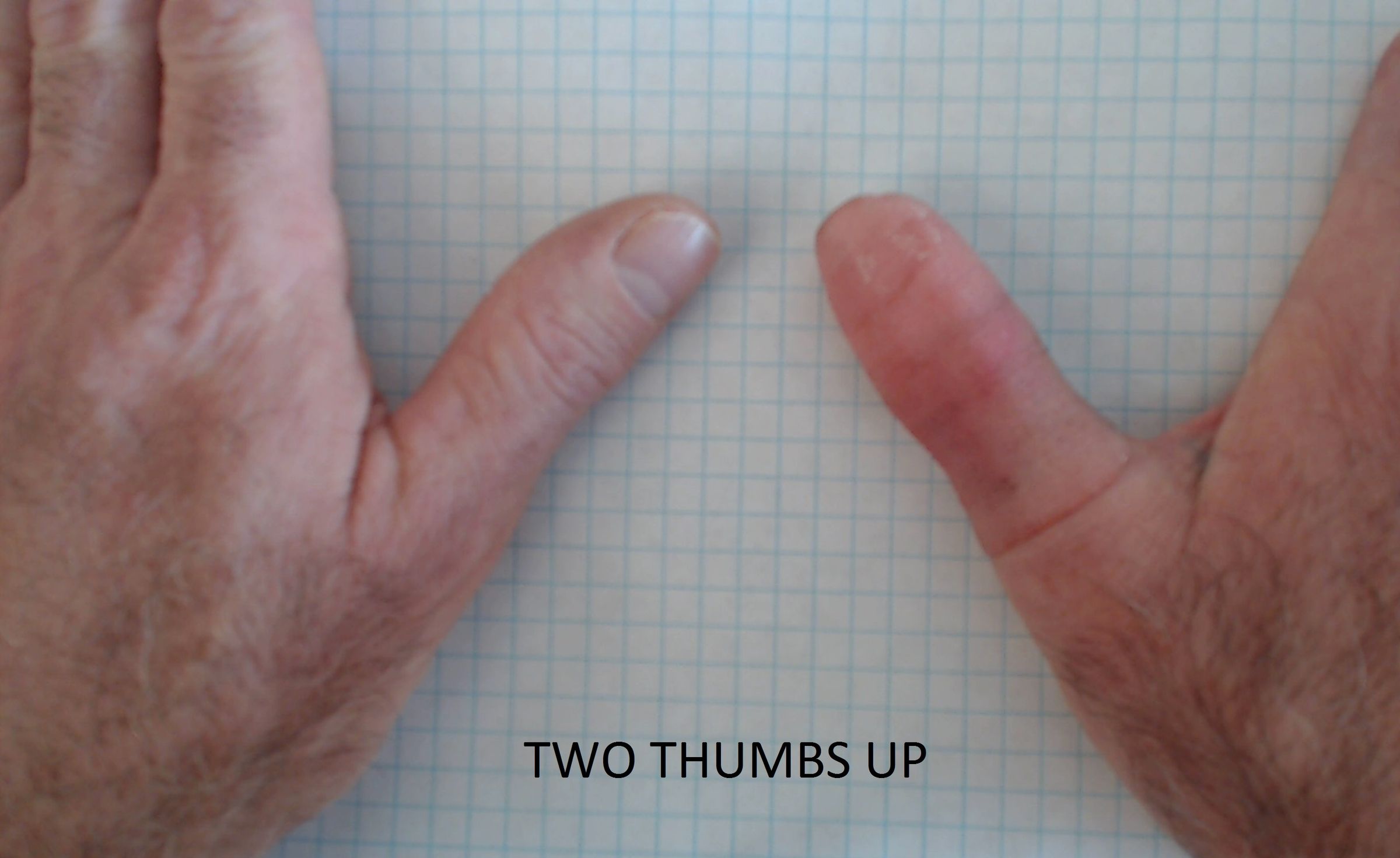 Thumb Prosthesis : 12 Steps (with Pictures) - Instructables