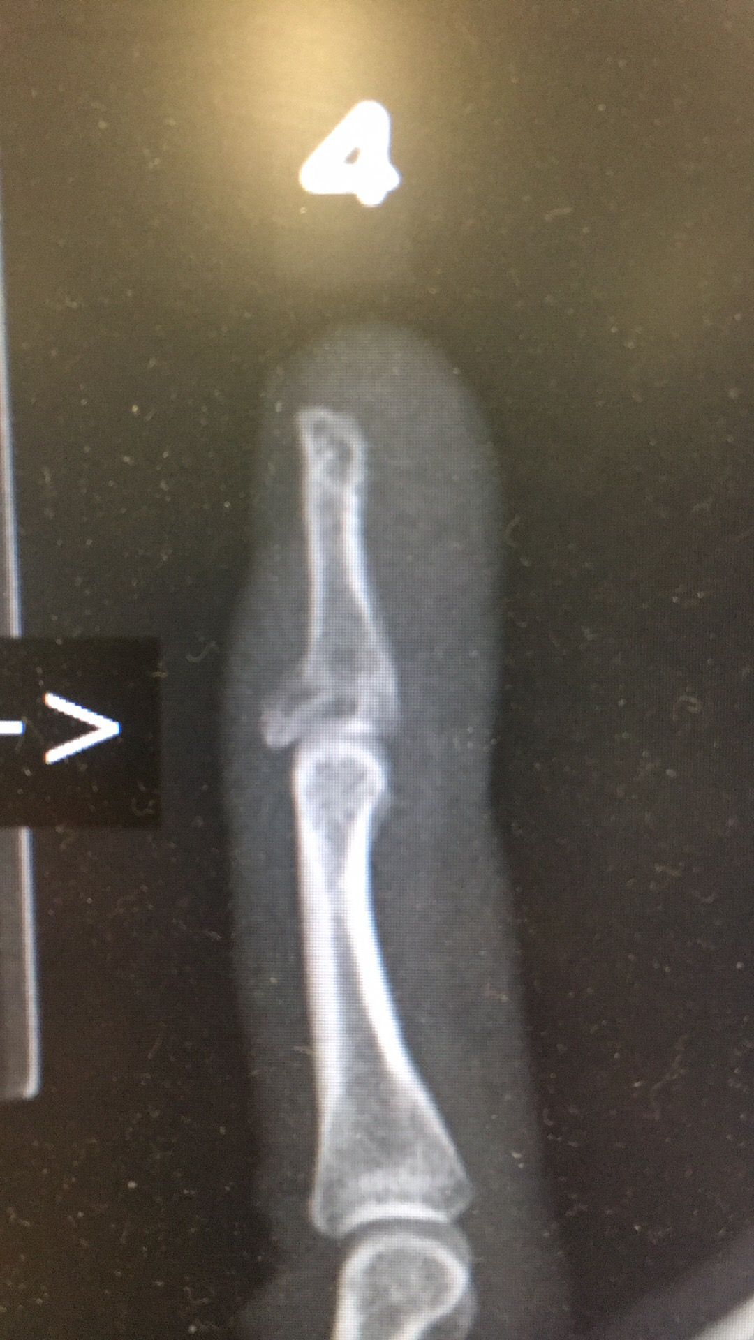 Custom 3D Printed Finger Splint : 3 Steps (with Pictures) - Instructables