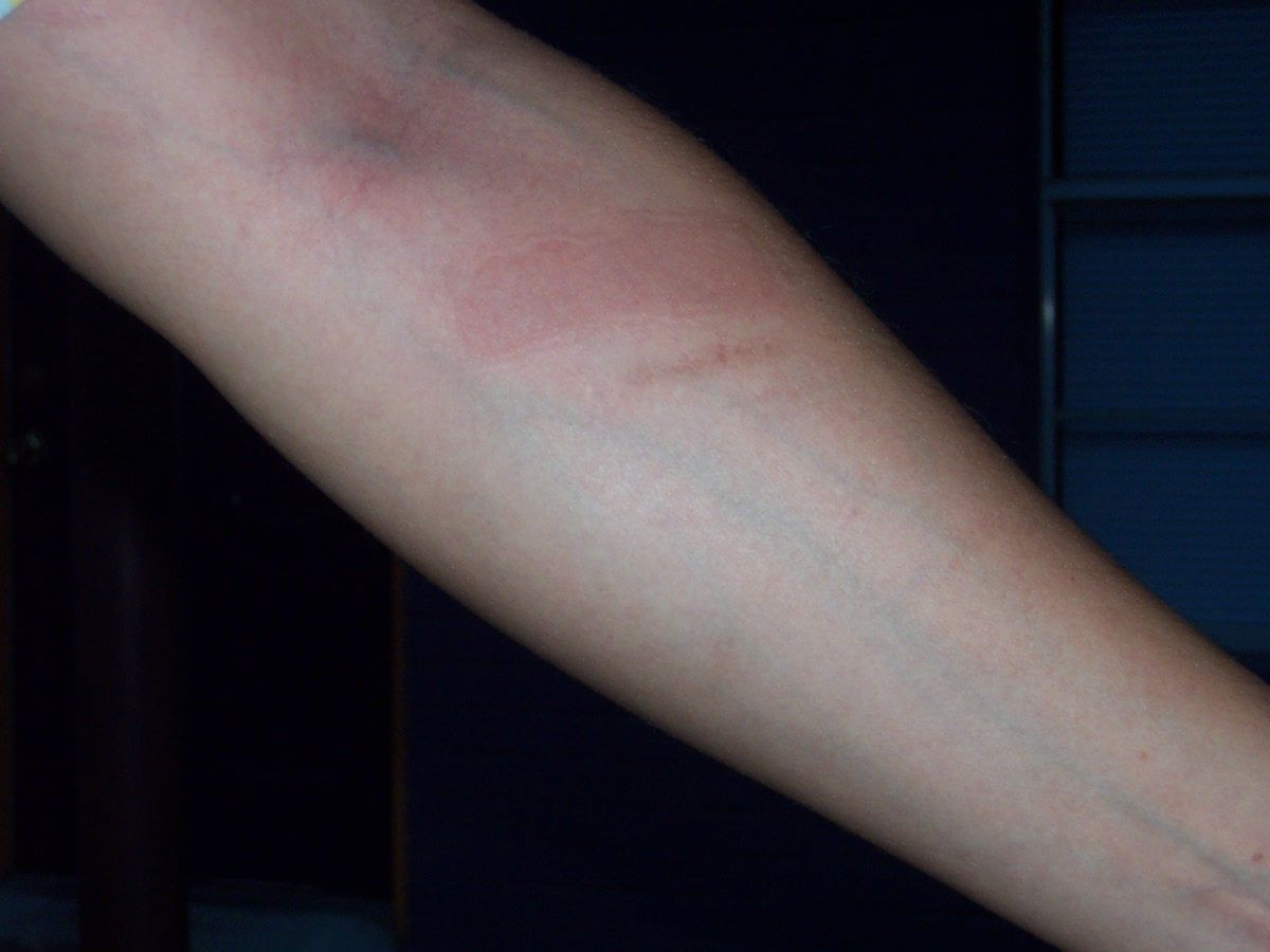 Human Freeze Branding