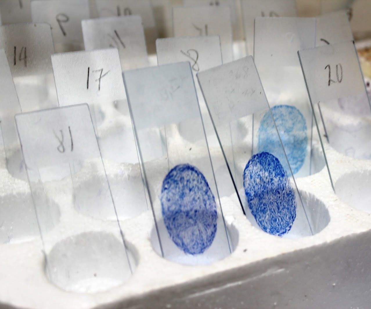 How to Make a Ziehl Neelsen Sputum Smear Slide : 9 Steps (with Pictures ...
