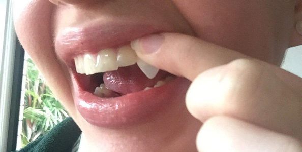 Grell Sutcliff Teeth / Vampire Fangs : 8 Steps - Instructables