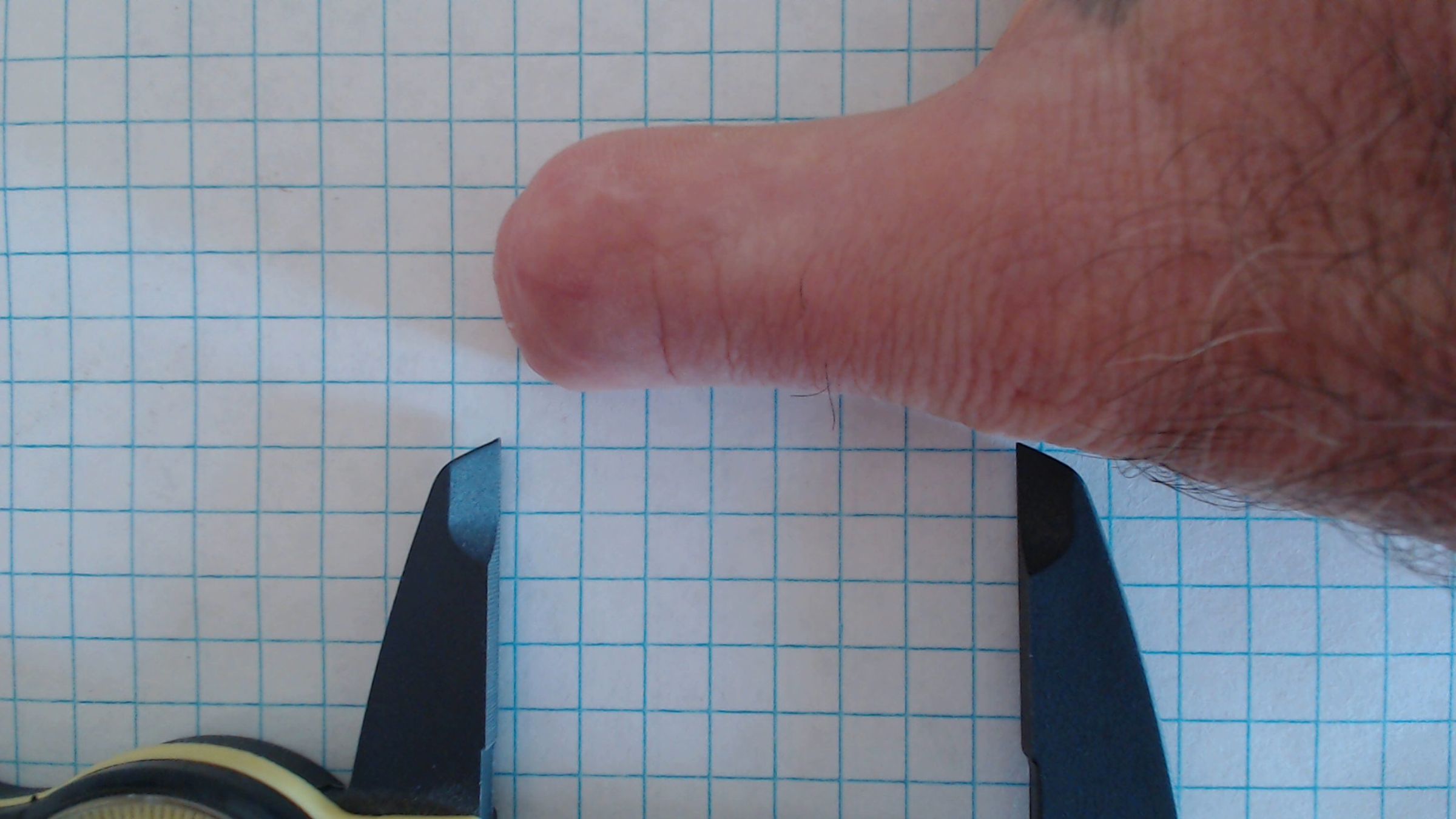 Thumb Prosthesis : 12 Steps (with Pictures) - Instructables