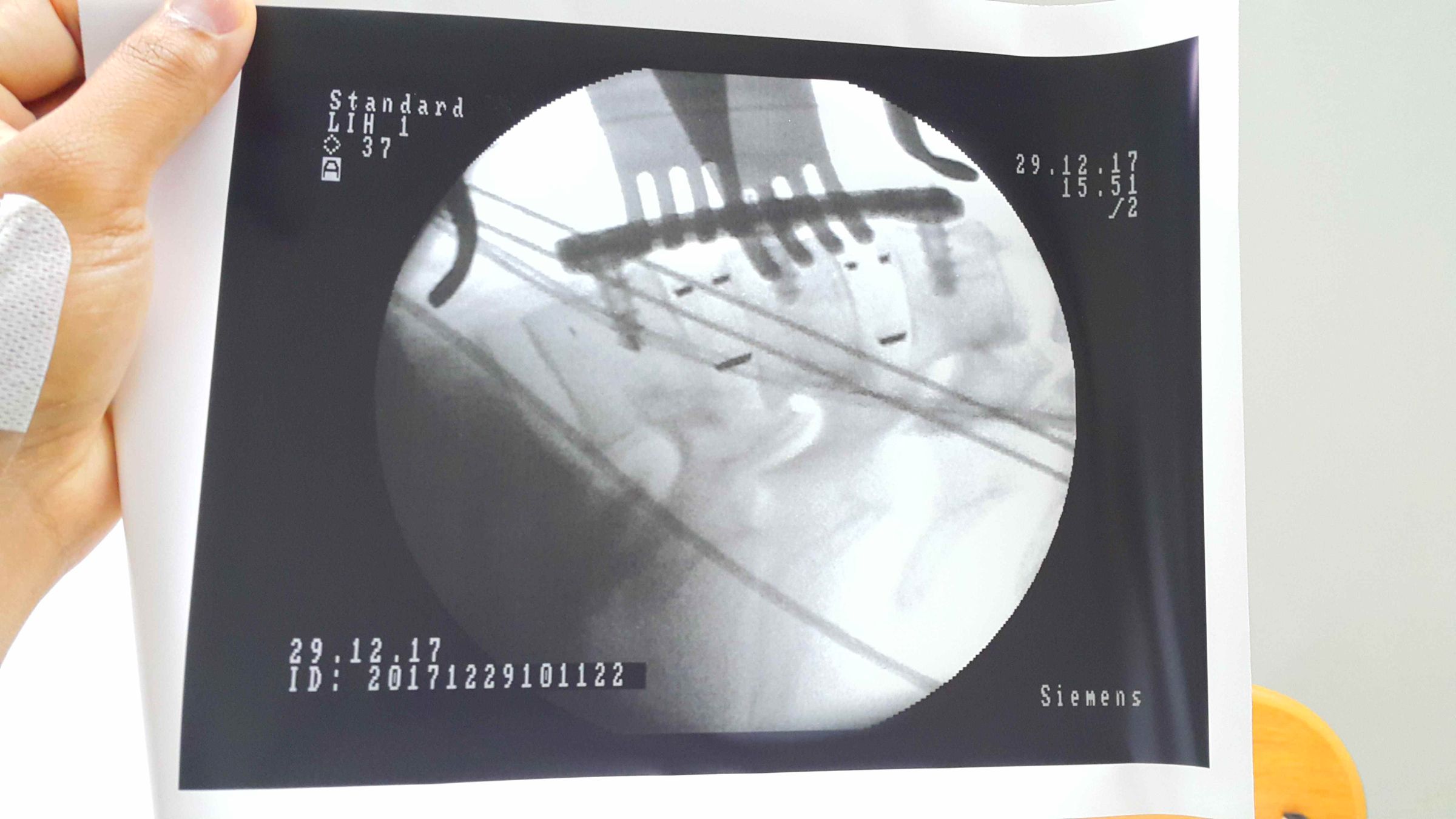 Coping With Anterior Cervical Discectomy and Fusion (ACDF) Surgery. : 3 ...