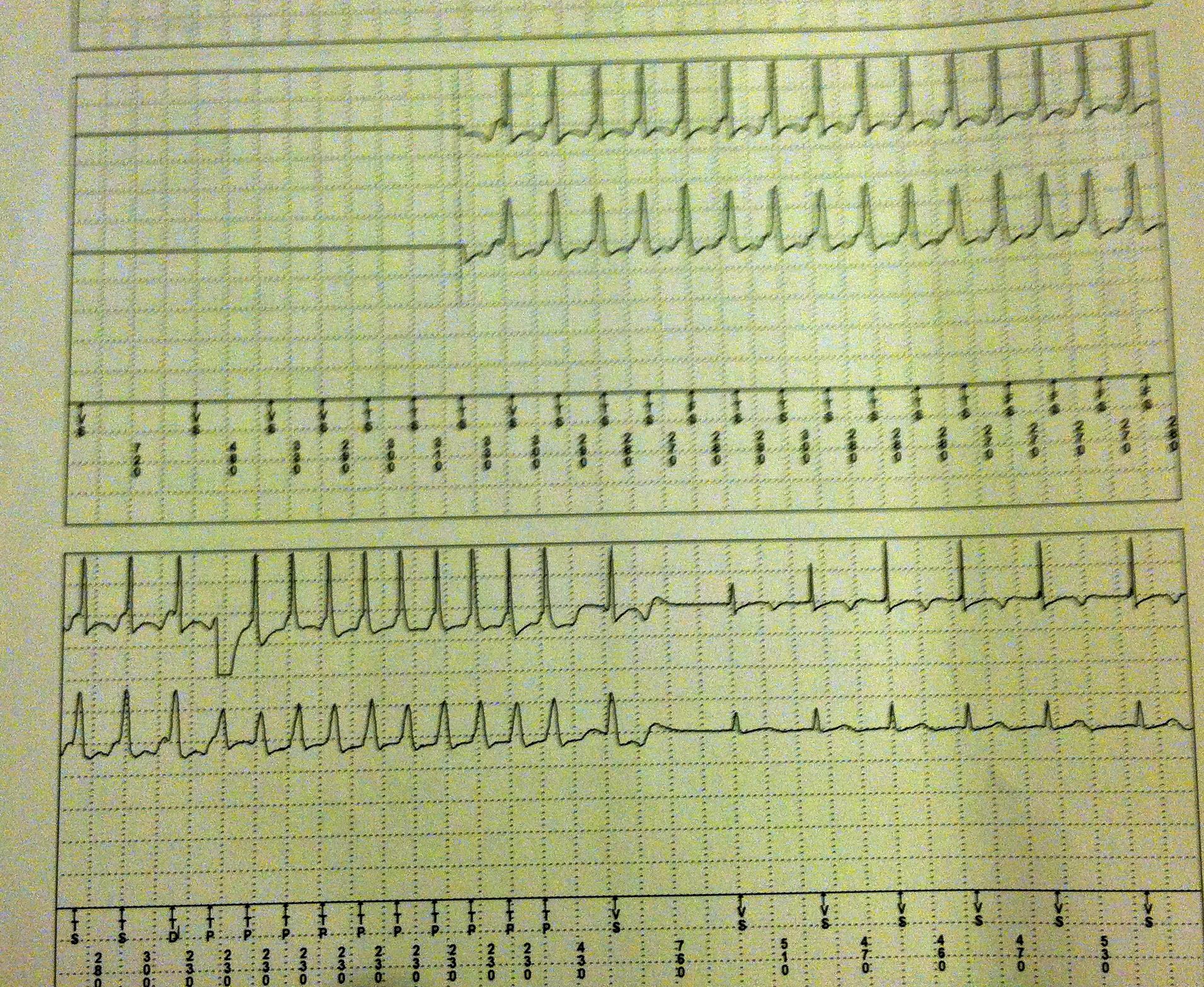 Tips for Living With Cardiac Rhythm Disorders/an ICD : 6 Steps ...