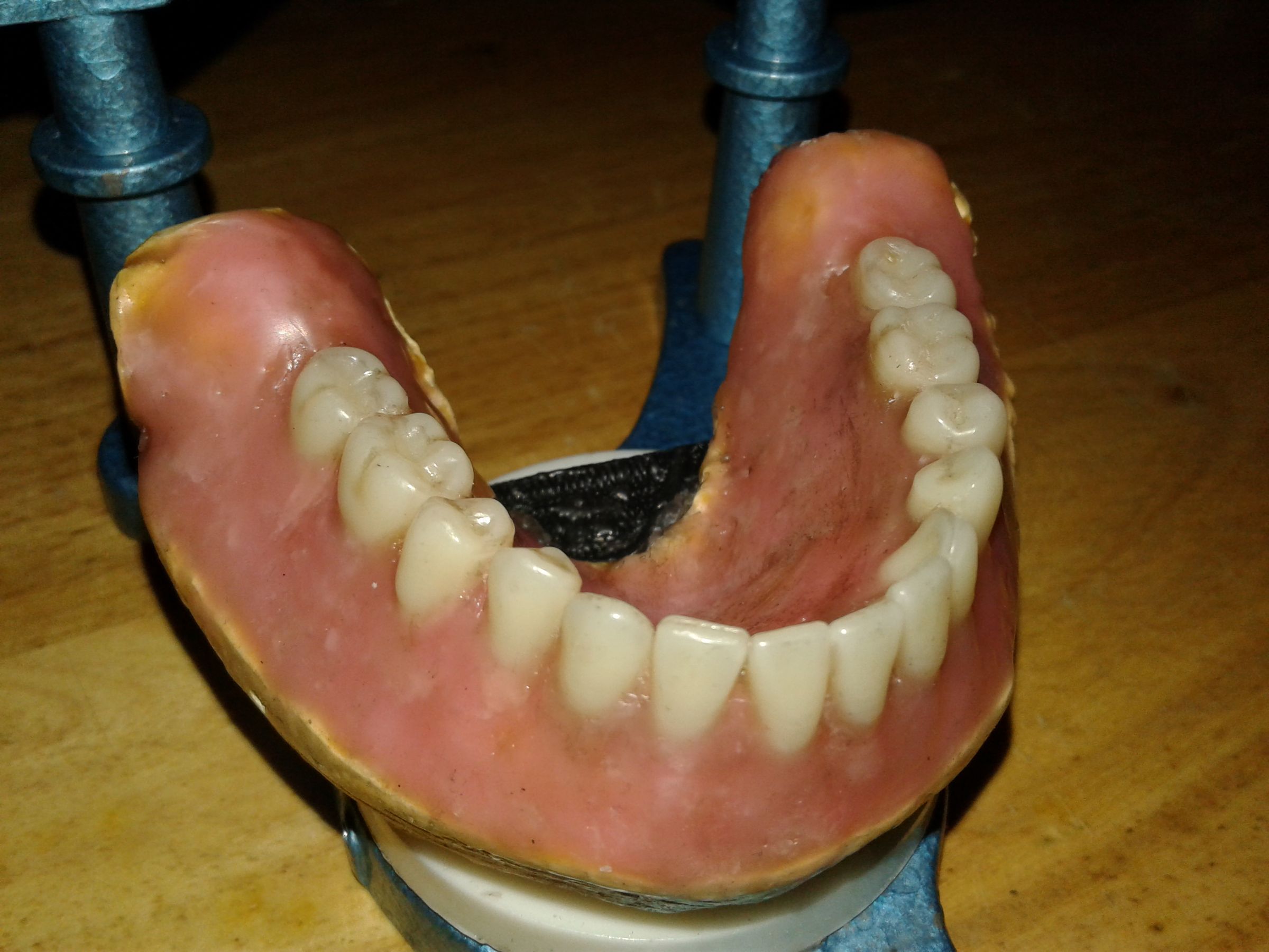 DIY Dentures : a Post-Surgical Plan : 12 Steps (with Pictures ...