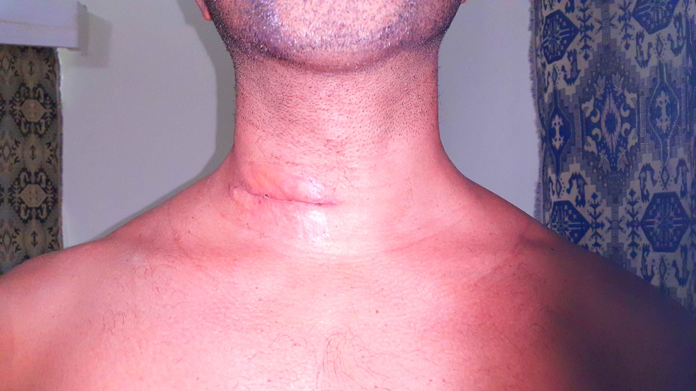 Coping With Anterior Cervical Discectomy and Fusion (ACDF) Surgery. : 3 ...