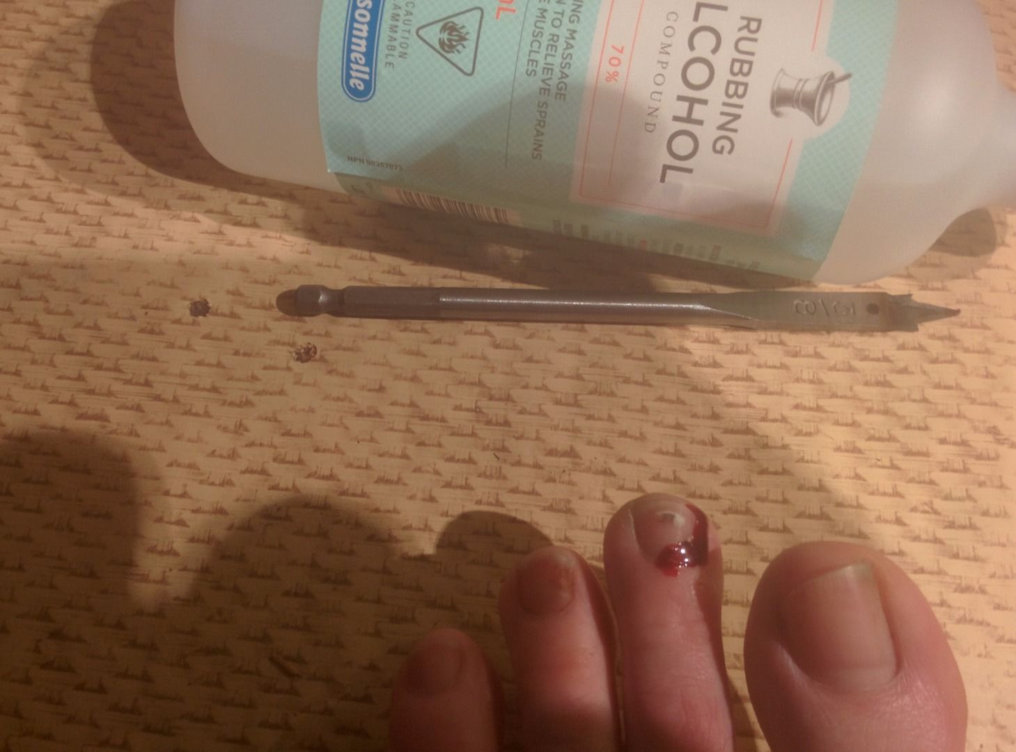 How to Drain Your Subungual Hematoma (blood Pocket Under Finger-nail ...
