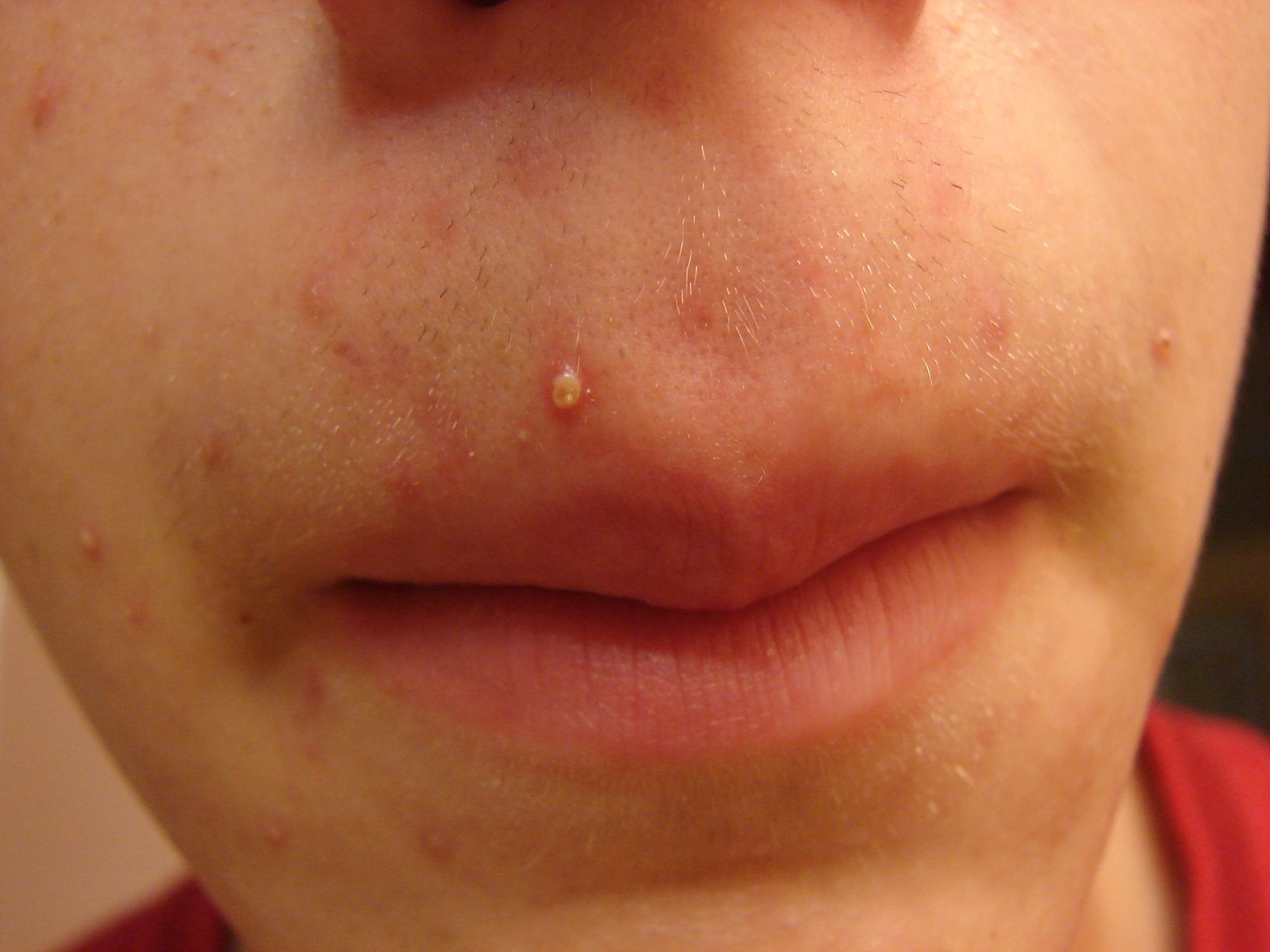 How to Pop a Pimple : 3 Steps (with Pictures) - Instructables