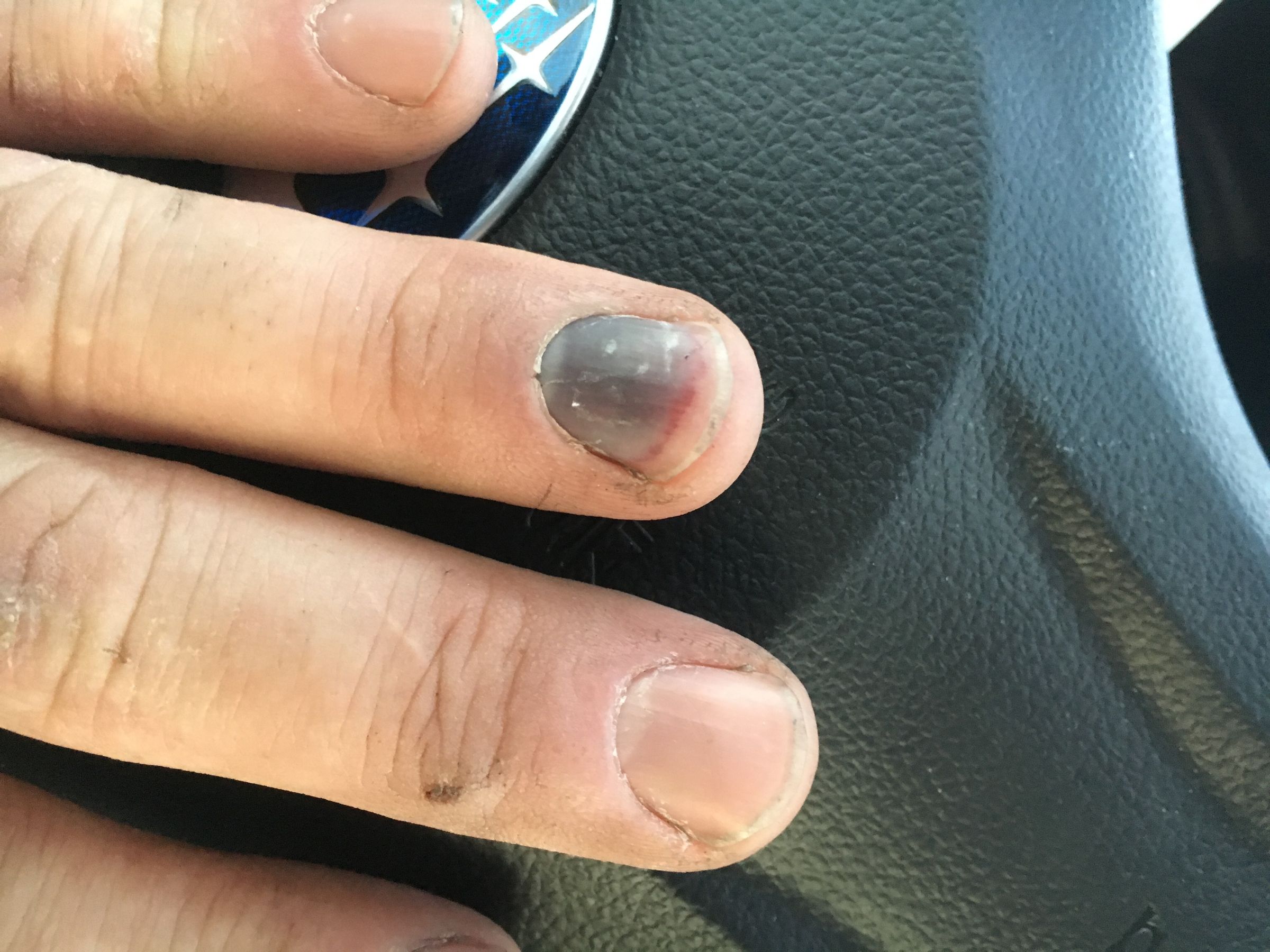 How to Drain Your Subungual Hematoma (blood Pocket Under Finger-nail ...