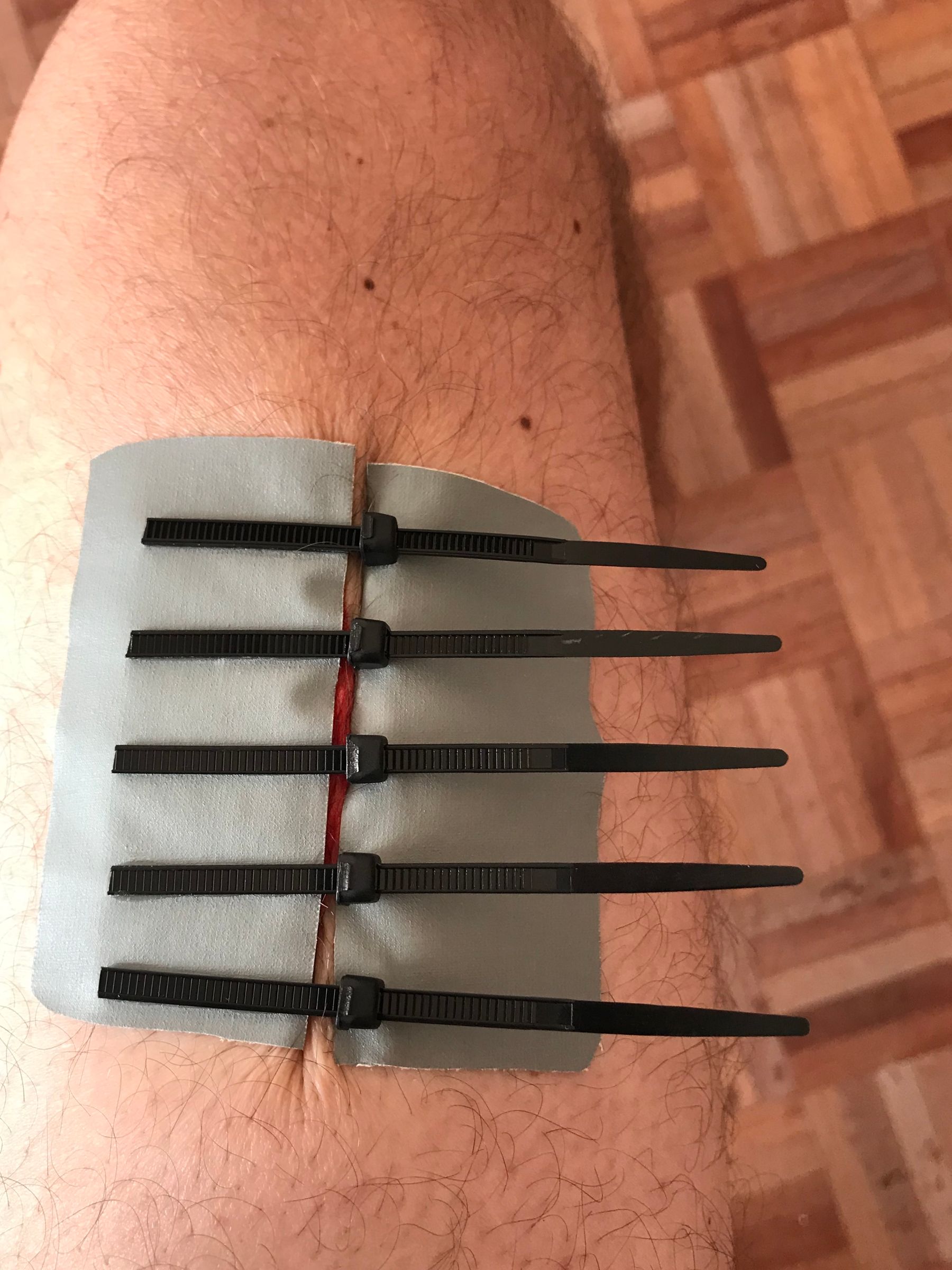 Wound Closing With Tape and Cable Ties (DIY Zipstitch) : 7 Steps (with ...