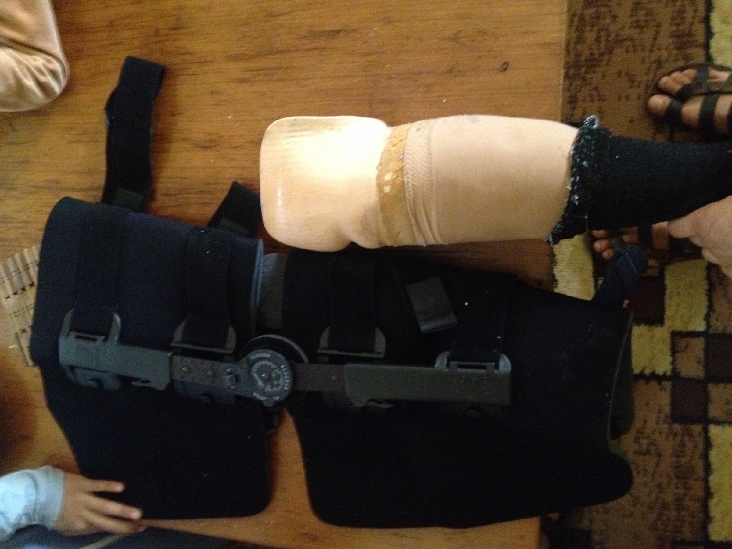 Prosthetics Modification for Pain Relief of Pressure Points (with ...