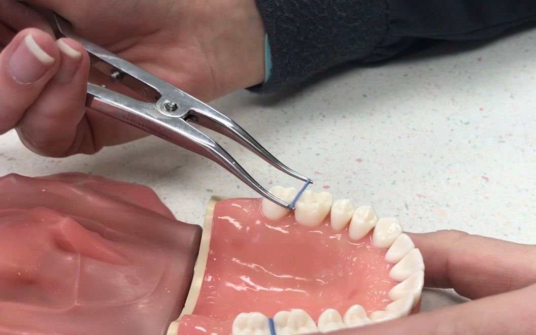 Placing & Removing Elastic Spacers : 5 Steps - Instructables