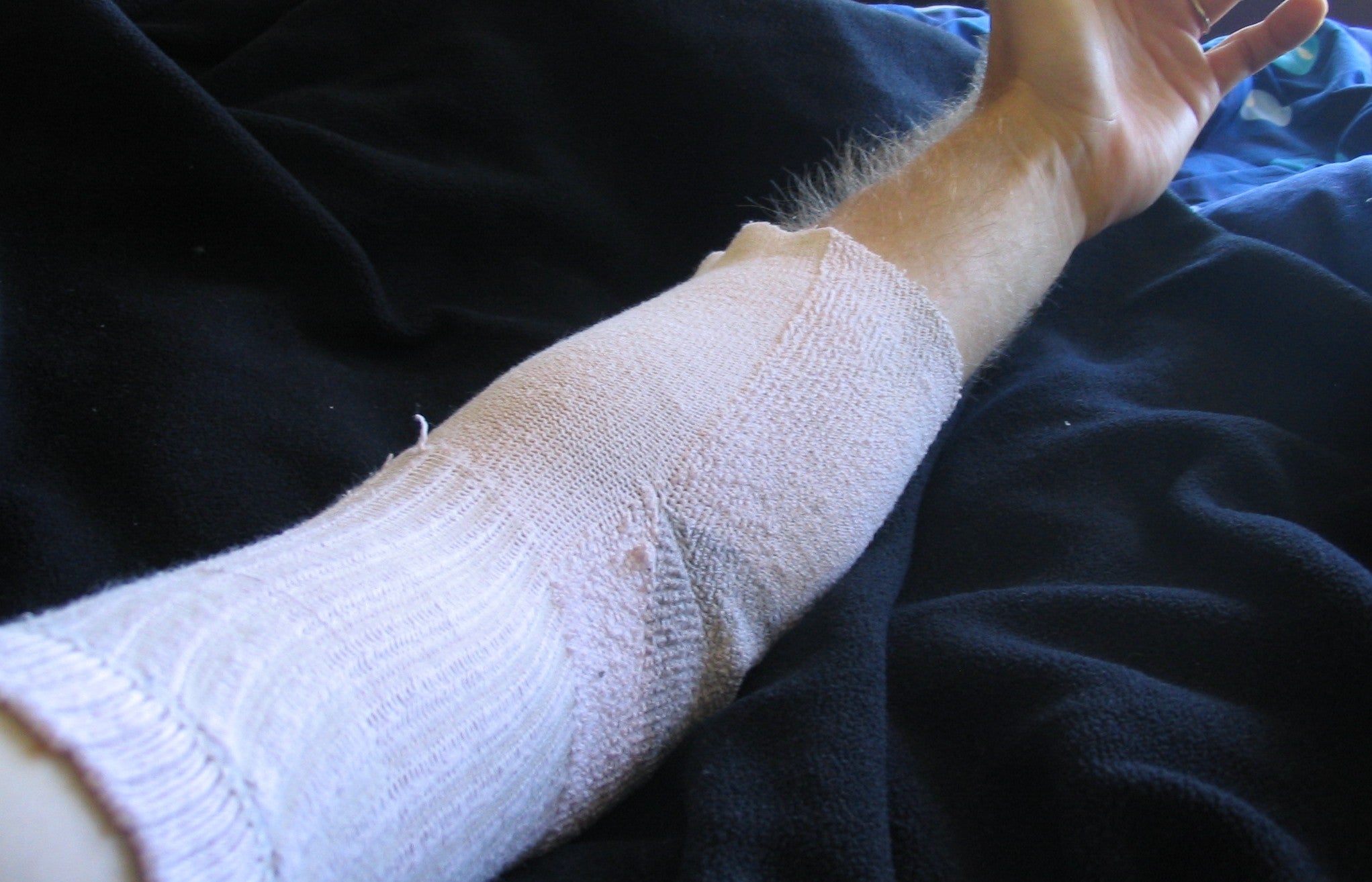 Sock Arm Bandage : 6 Steps - Instructables