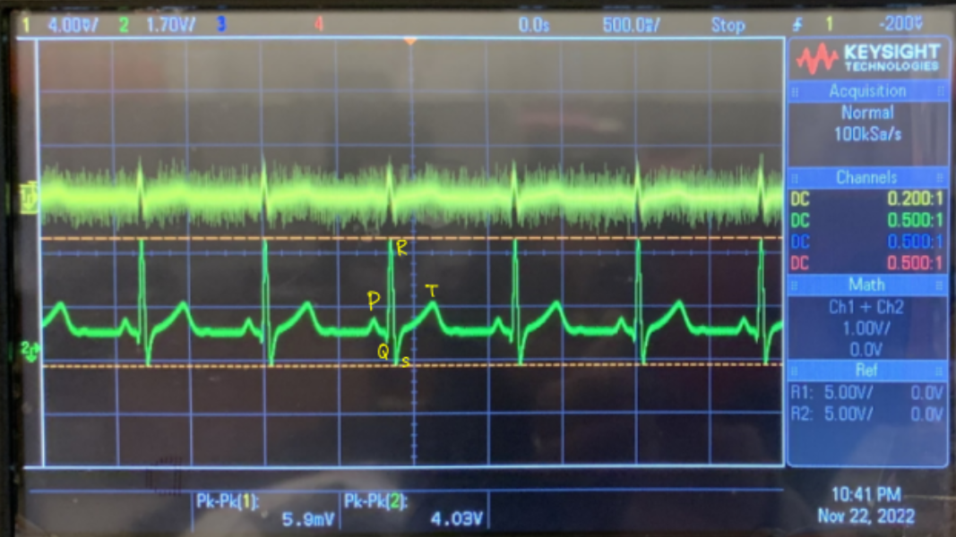 The Do-It-Yourself Electrocardiogram (ECG) : 6 Steps - Instructables