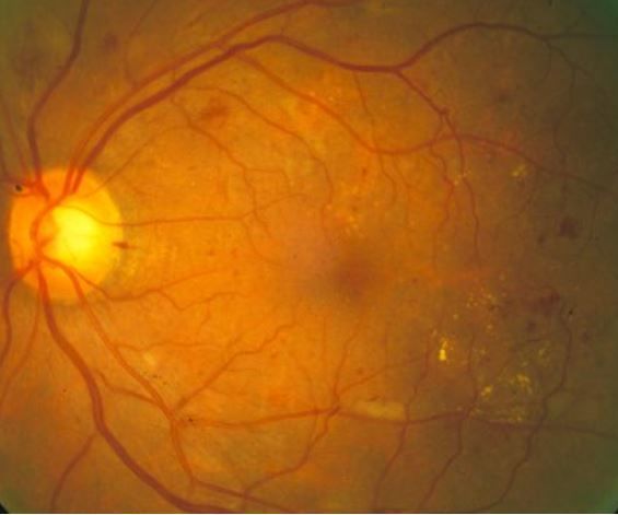 Automated Diagnosis of Diabetic Retinopathy Via MATLAB : 33 Steps ...