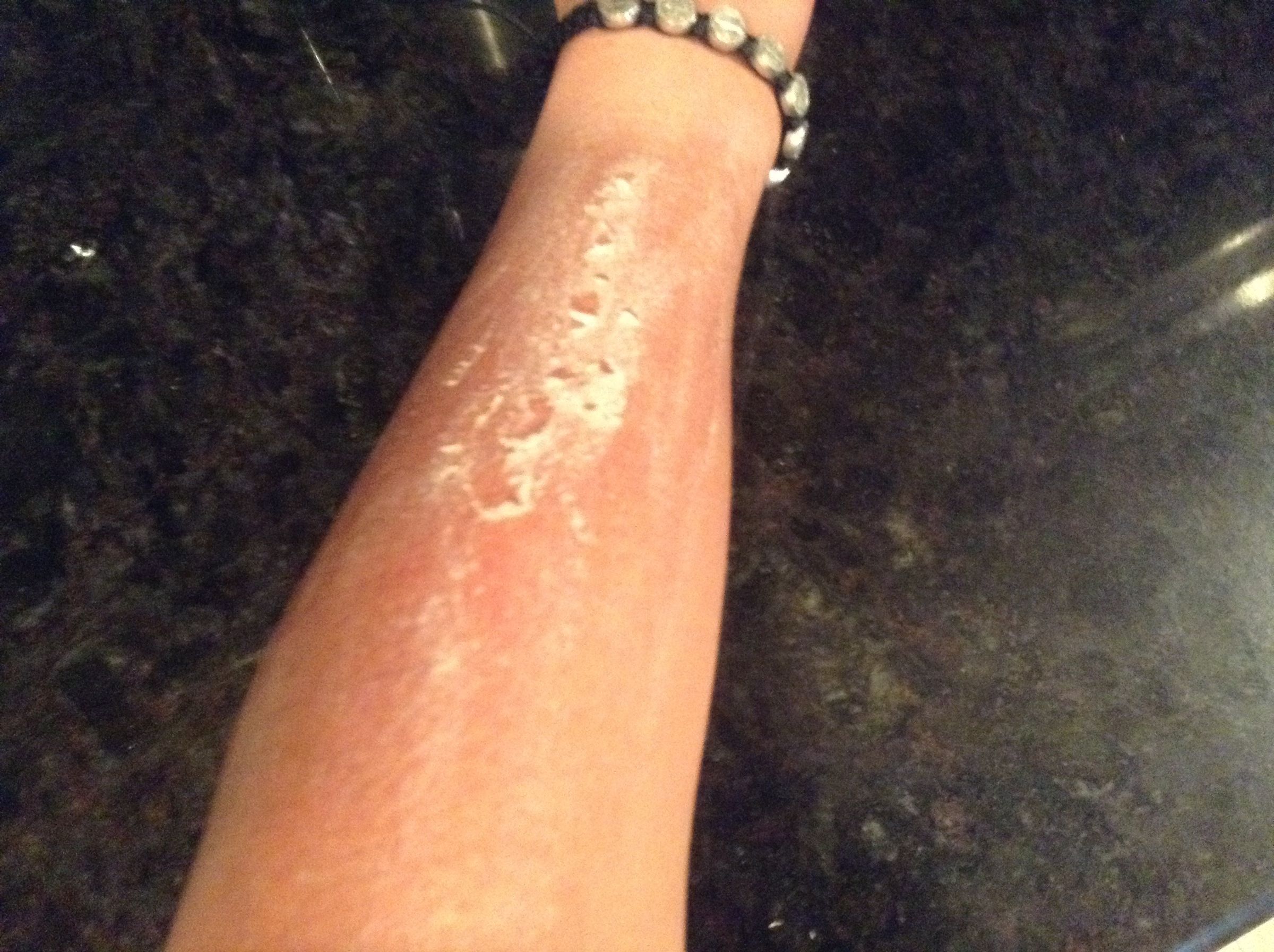 How to Scrape Your Arm : 5 Steps - Instructables