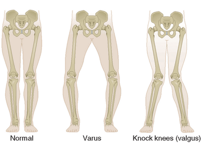 Haptic Knee Valgus Correction System : 6 Steps - Instructables