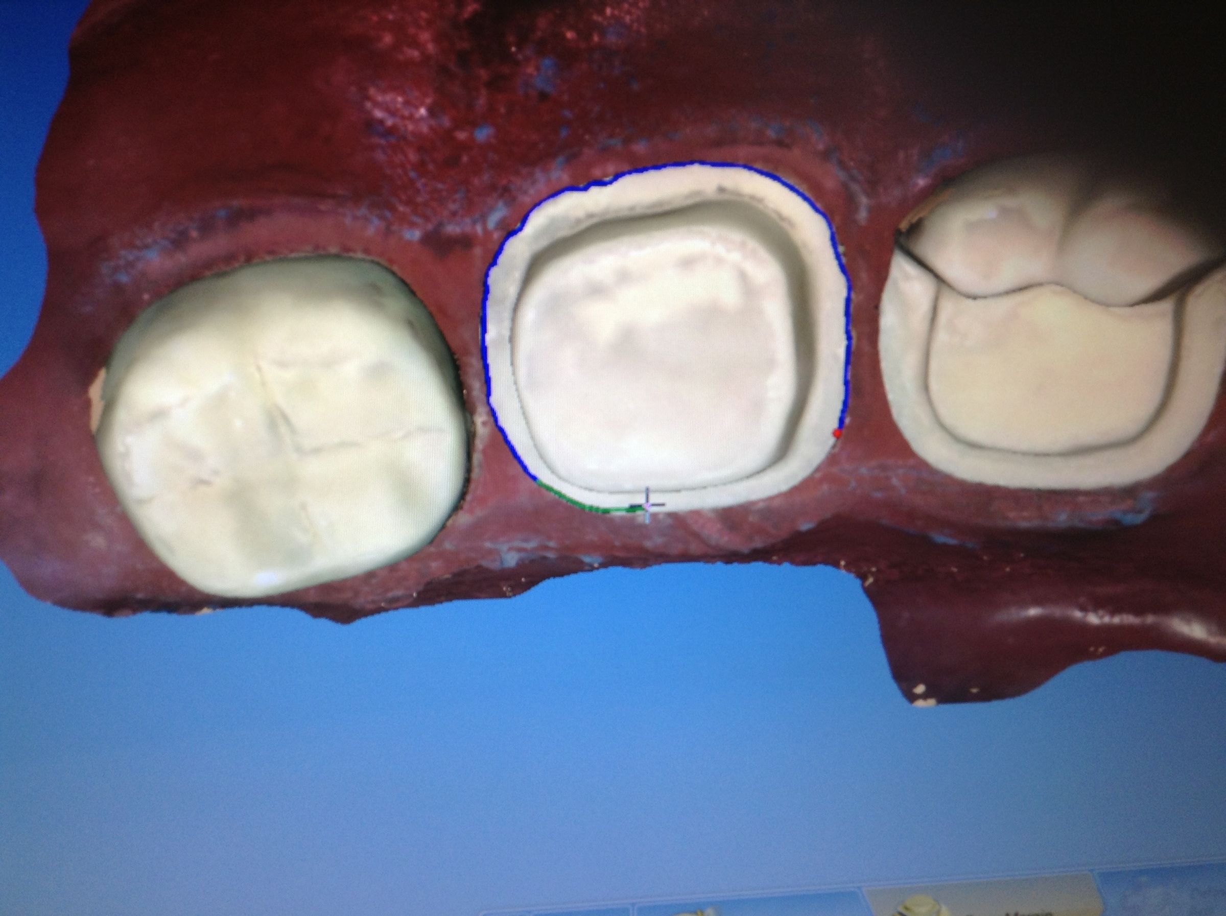 How to Fix a Tooth With CAD/CAM (CEREC) : 9 Steps (with Pictures ...